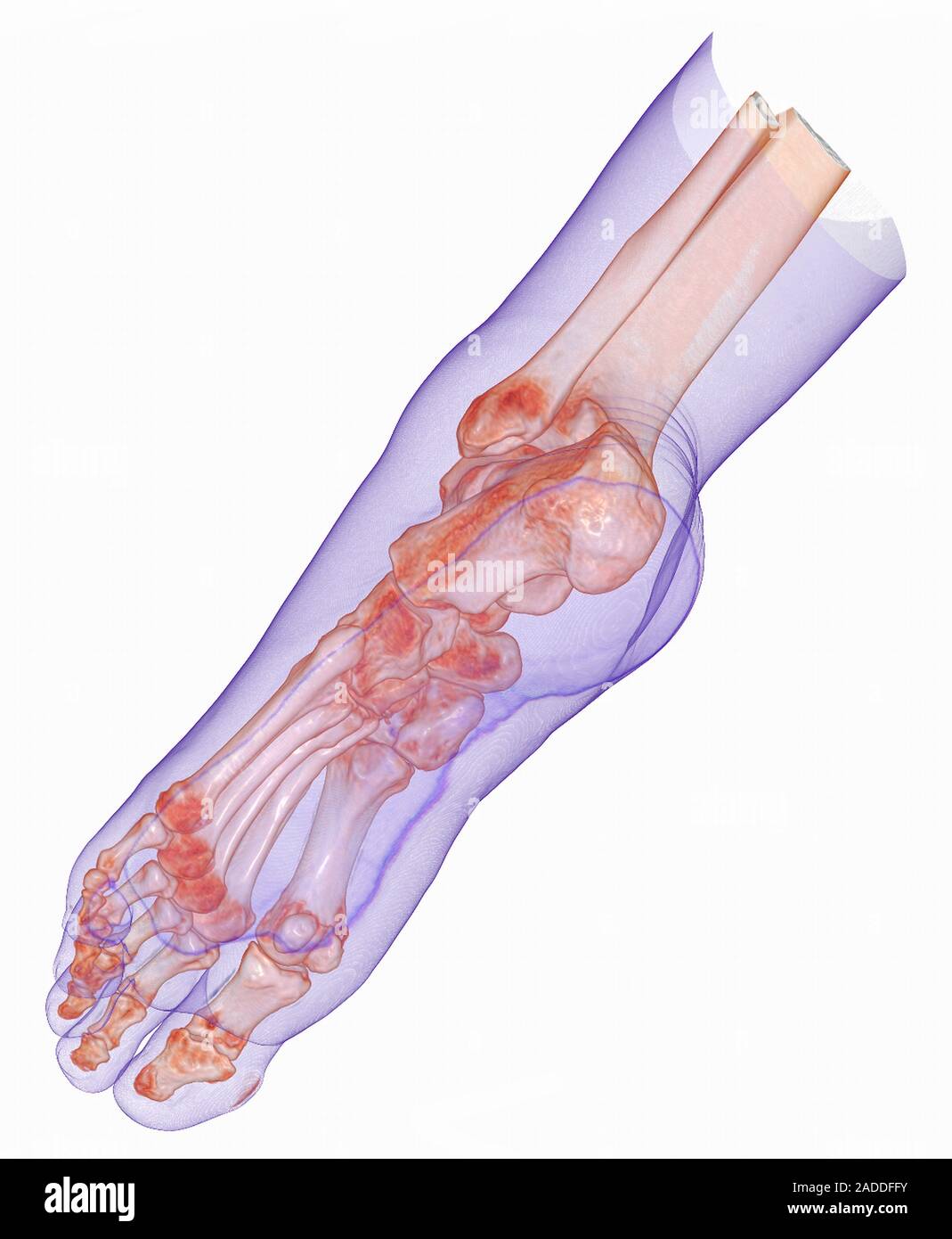 Human foot and ankle. 3D coloured computed tomography (CT) scan of the ...
