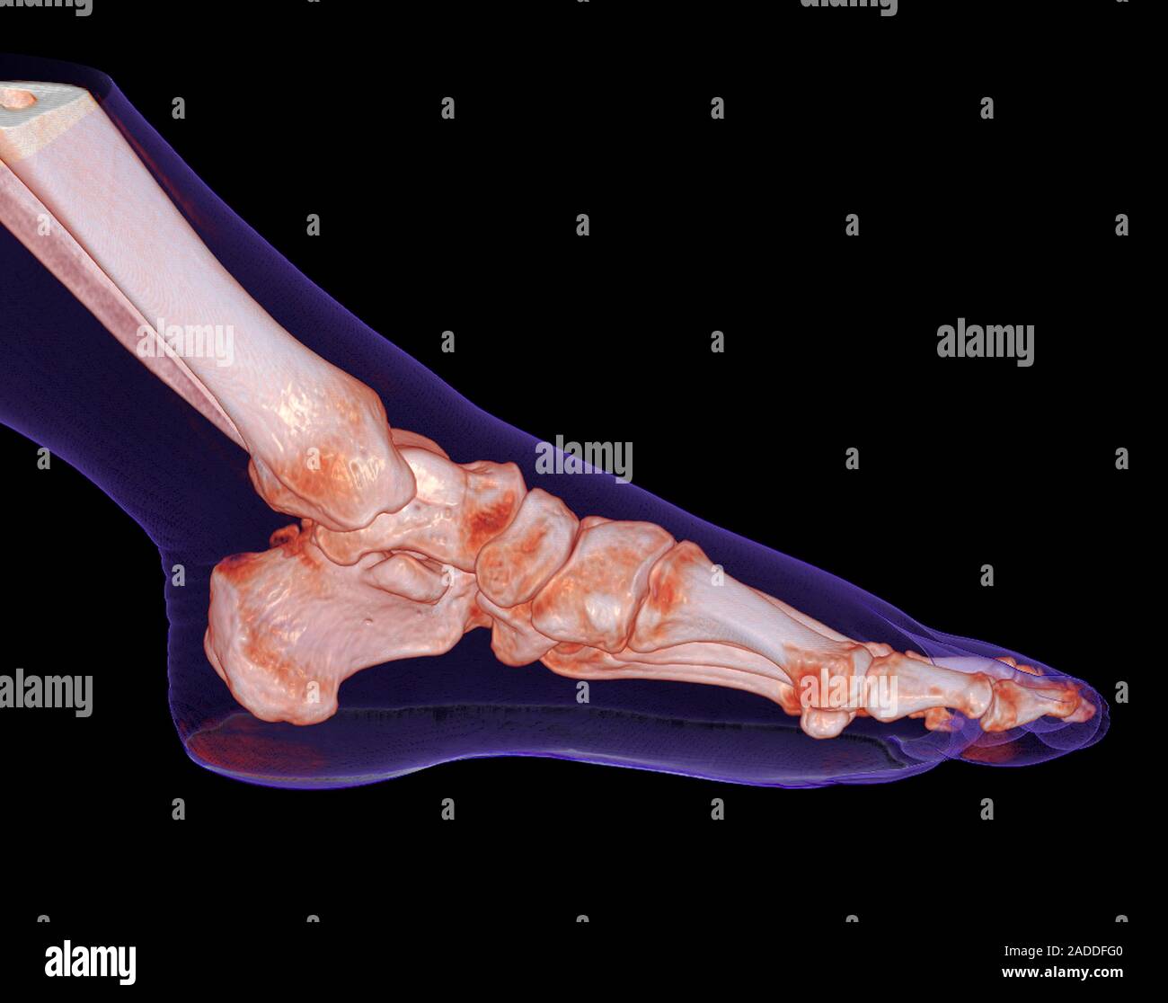 Human foot and ankle. 3D coloured computed tomography (CT) scan of the ...