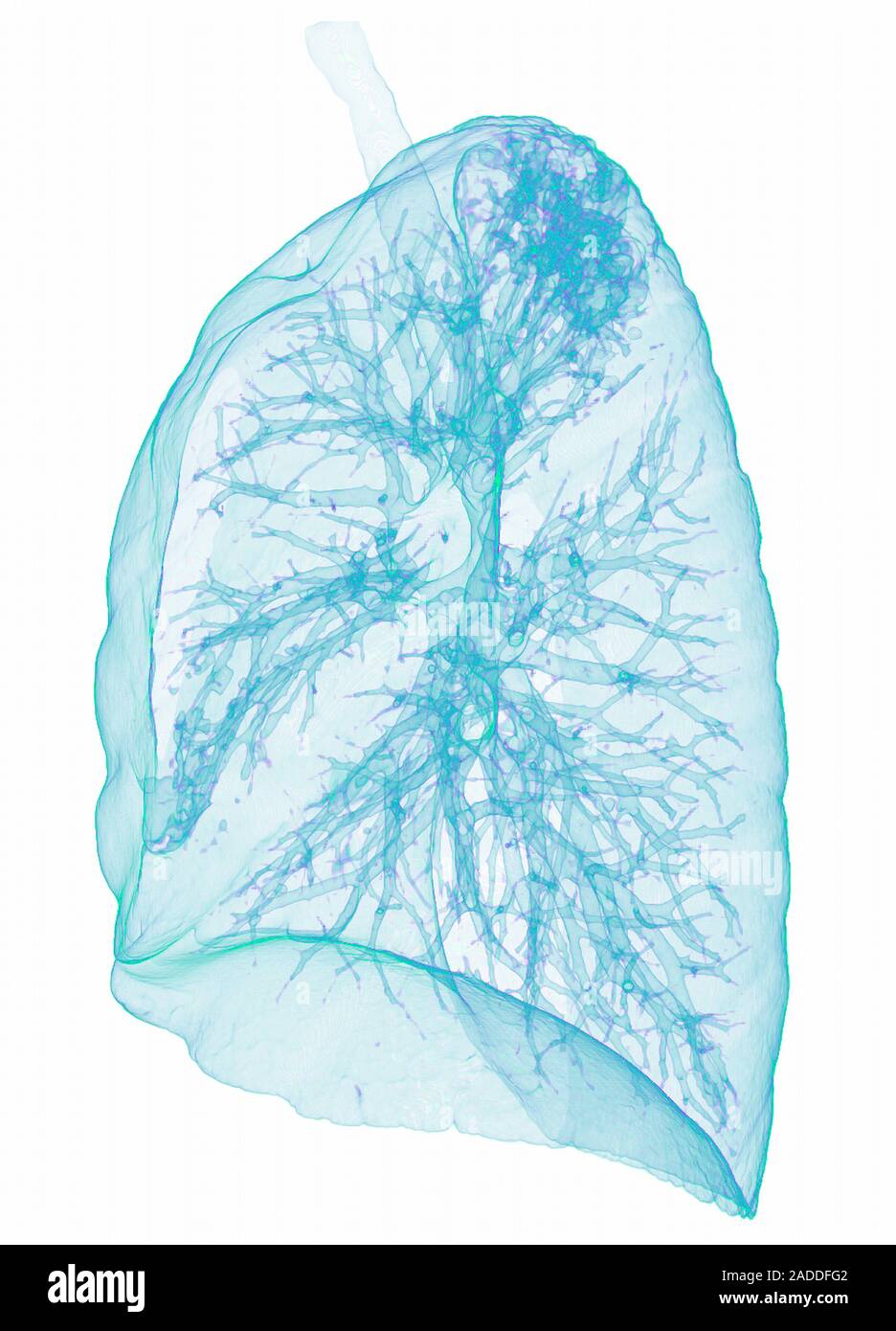 Pulmonary tuberculosis. Coloured lateral 3D computed tomography (CT ...