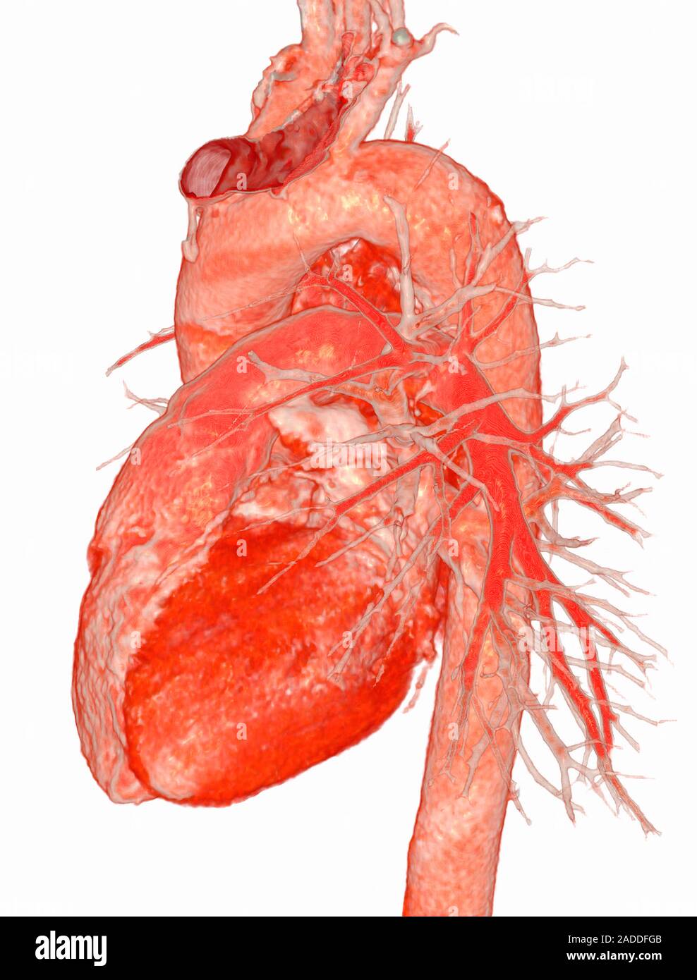 Human heart, 3D coloured computed tomography (CT) angiogram. This is an ...