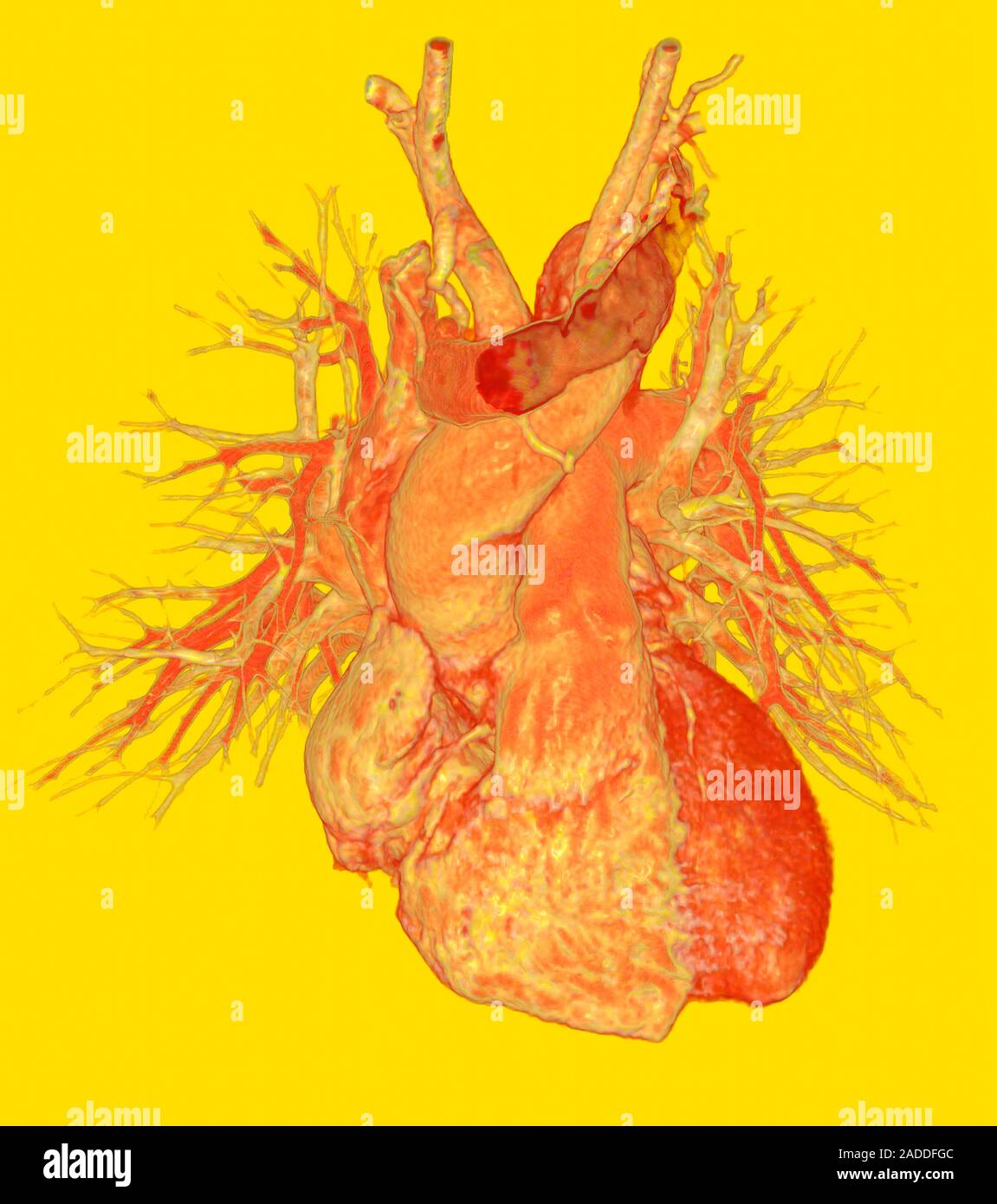 Human heart, 3D coloured computed tomography (CT) angiogram. This is an ...