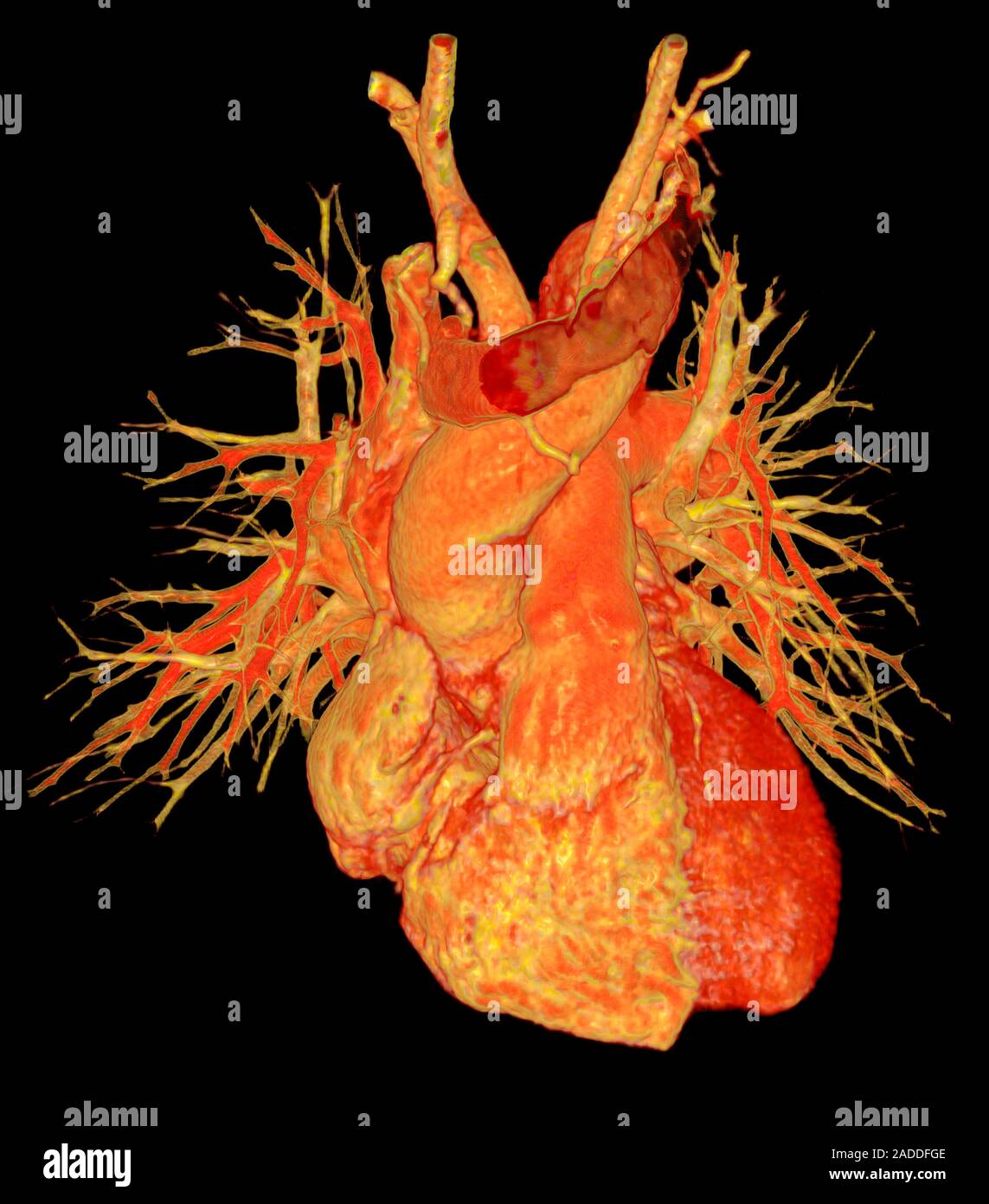 Human heart, 3D coloured computed tomography (CT) angiogram. This is an ...