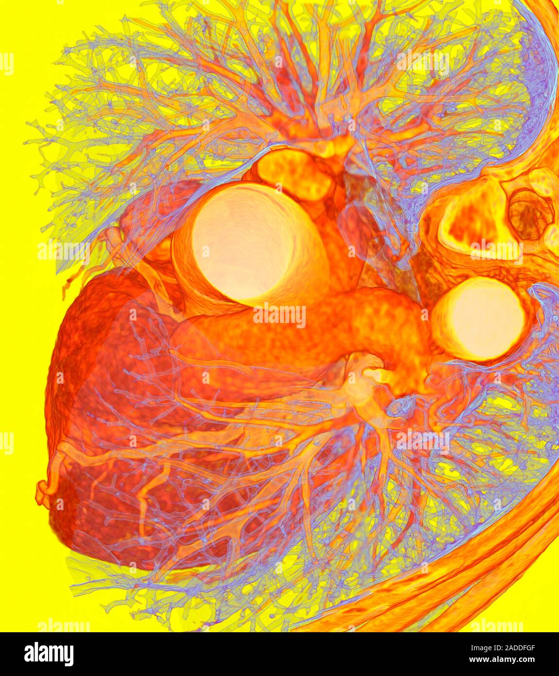 Human heart, 3D coloured computed tomography (CT) angiogram. This is an ...