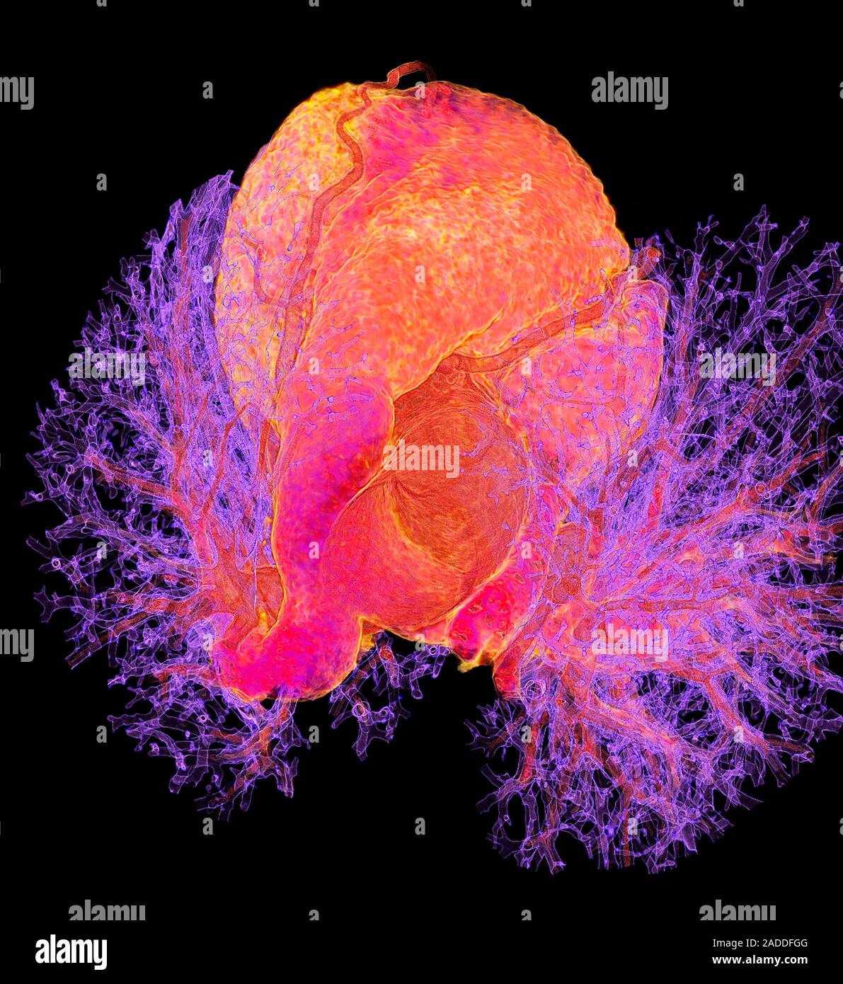 Human heart, 3D coloured computed tomography (CT) angiogram. This is a ...