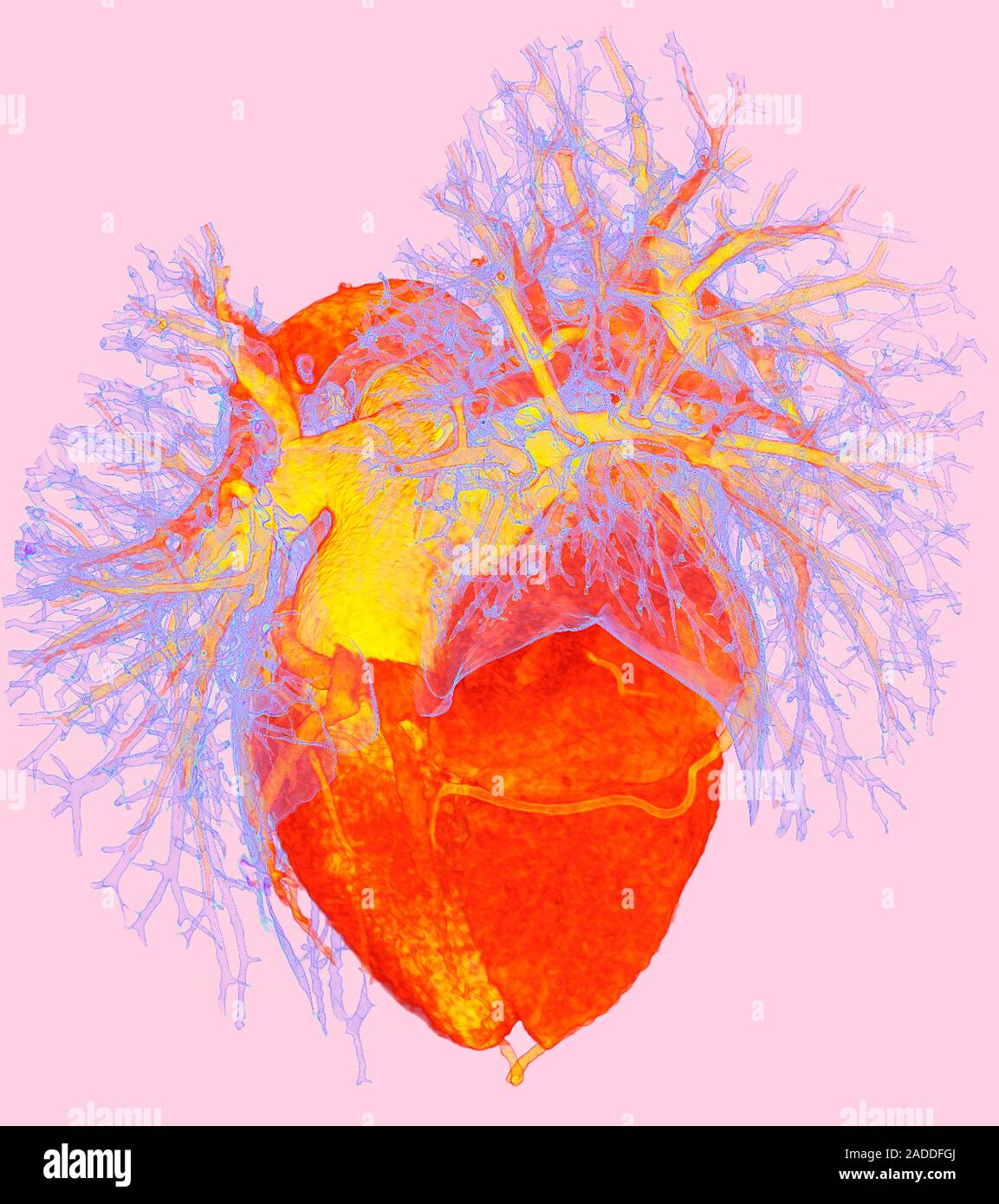 Human heart, 3D coloured computed tomography (CT) angiogram. This is a posterior (rear) view ...