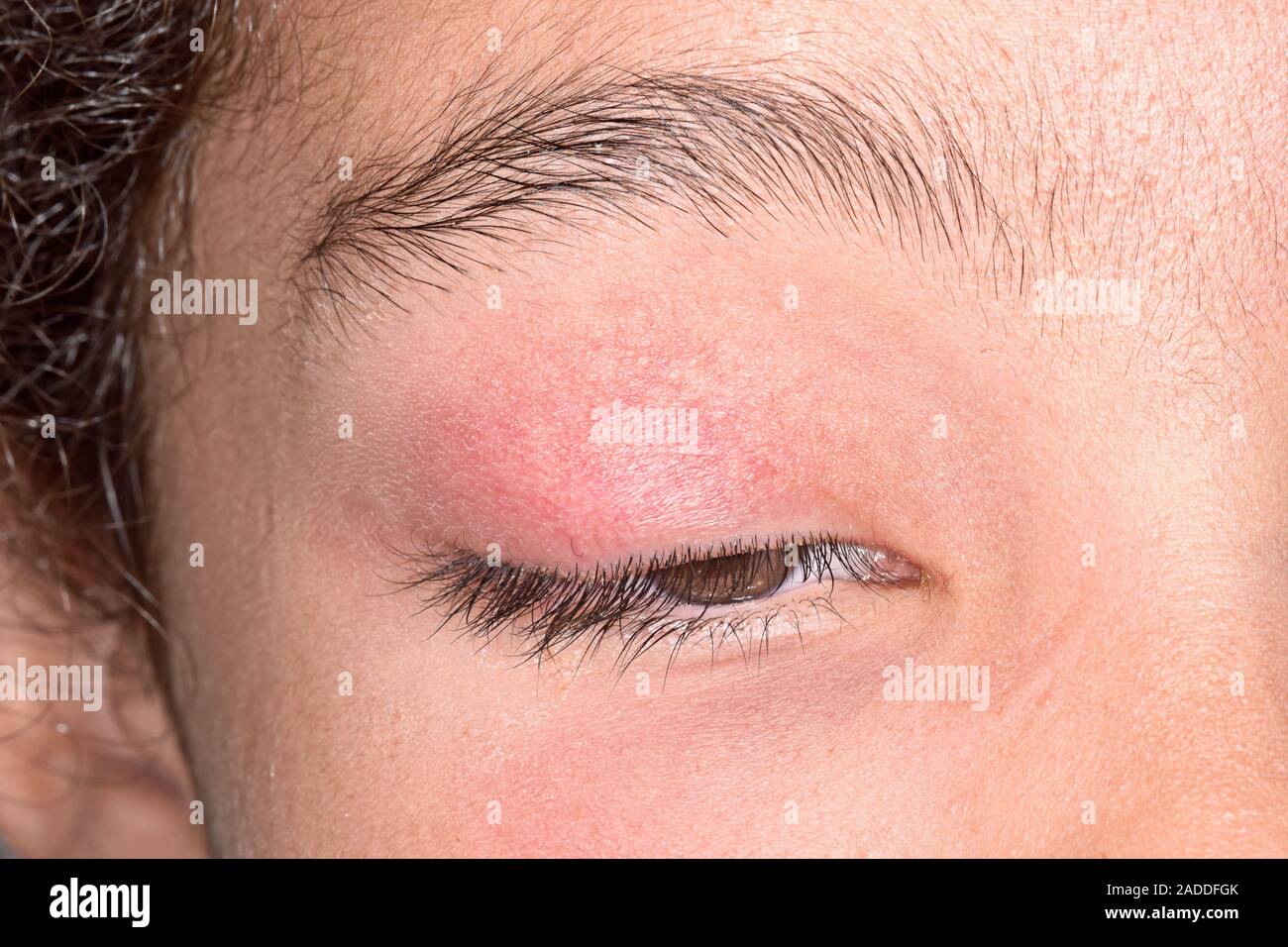 MODEL RELEASED. Periorbital cellulitis on the upper eyelid of the right ...