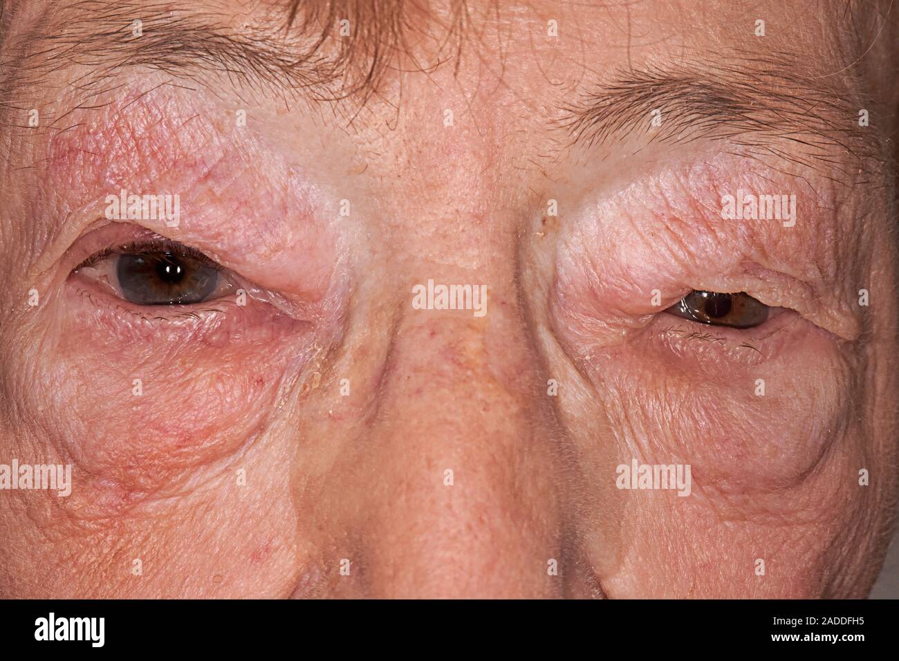 MODEL RELEASED. Angioedema of the eyelids of an 89-year-old woman as a ...