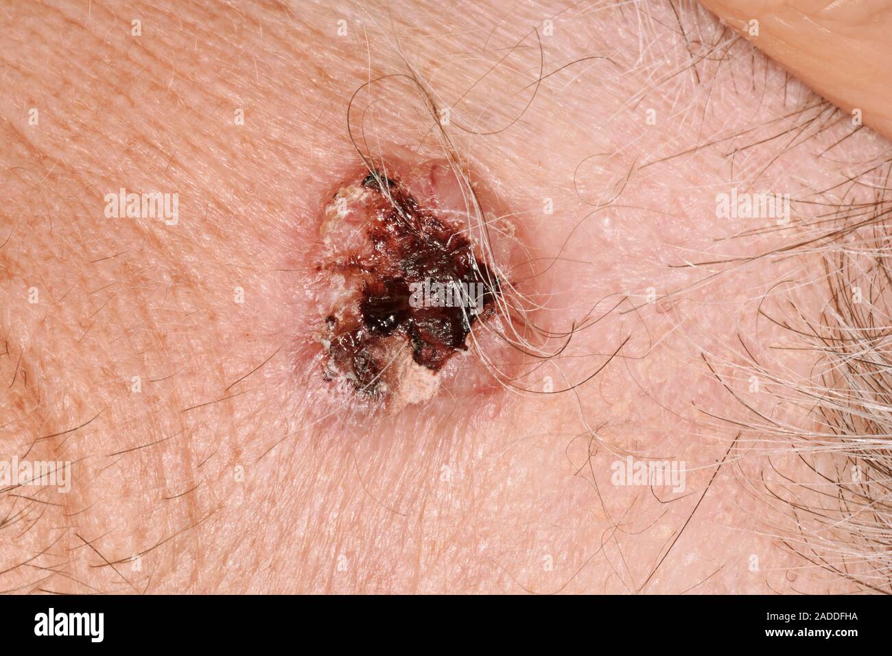 Squamous And Basal Cell Carcinomas On The Temple Of An 85 Year Old