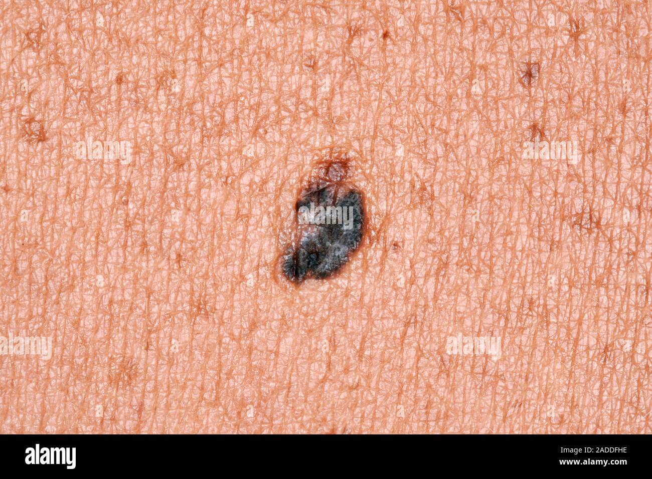 Malignant melanoma on the skin of the back of a 52-year-old woman ...