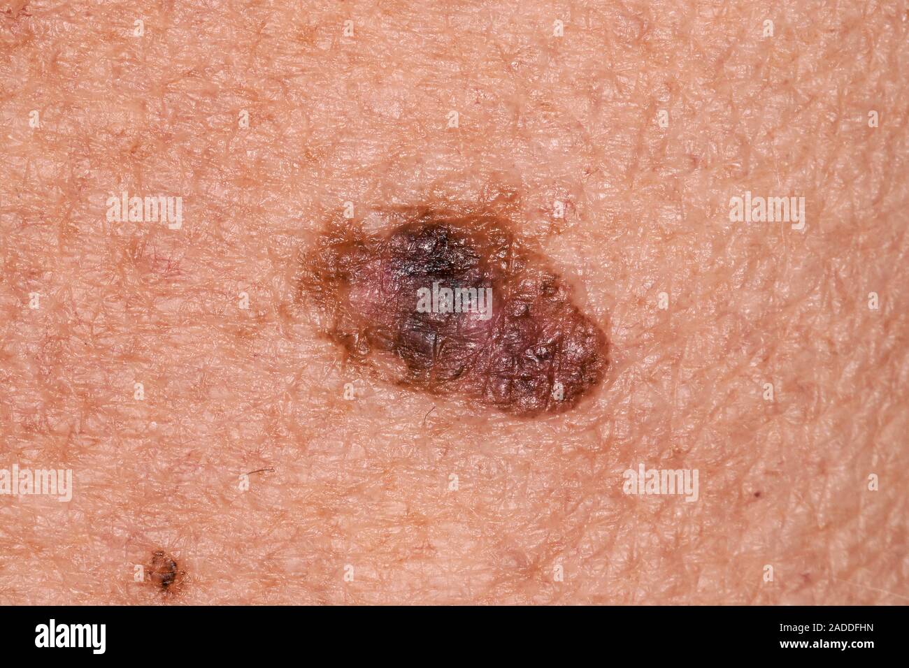 Melanoma in situ on the skin of a 77-year-old woman. Melanoma is a form ...