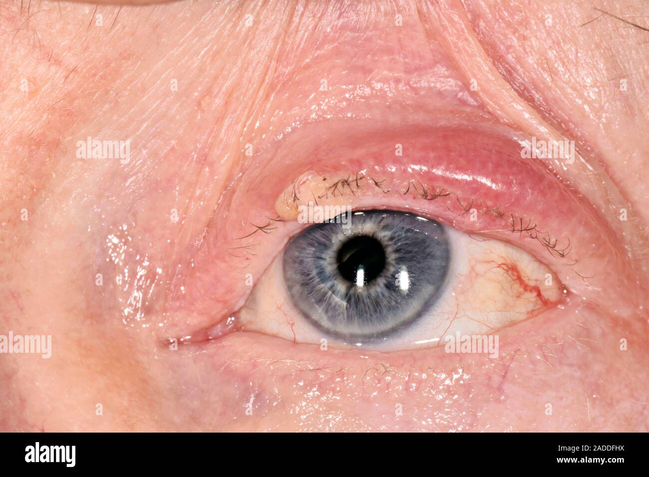 Chalazion abscess on an eyelid in a 79-year-old man. This condition ...