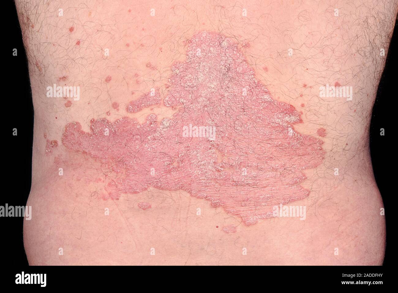 Psoriasis on the lower back of a 67-year-old man. Psoriasis is the ...