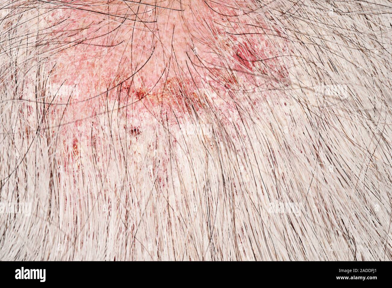 Psoriasis on the scalp of a 67-year-old man. Psoriasis is the presence ...