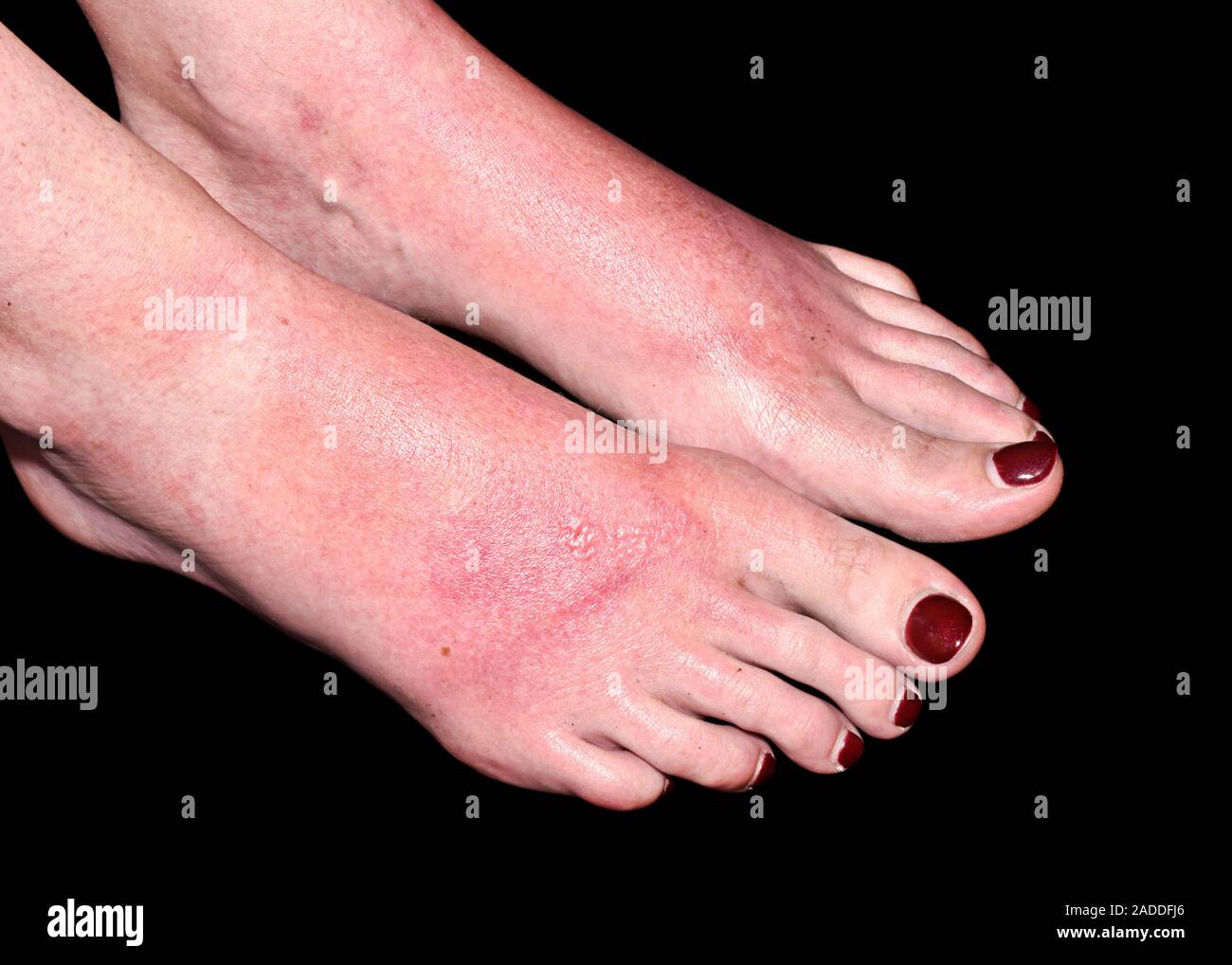 Sunburn on the feet of a 20-year-old woman, seen as areas of inflamed ...