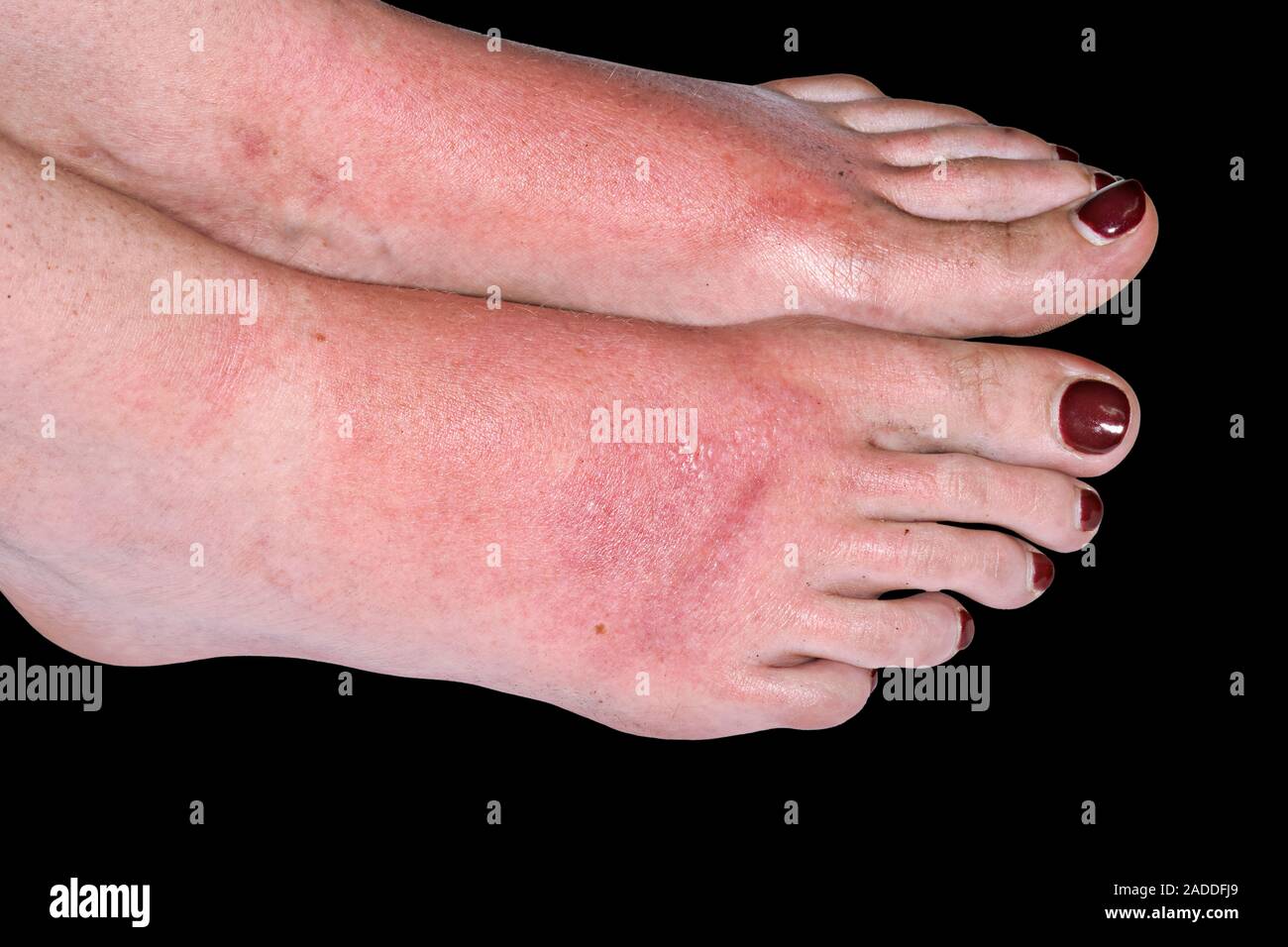 Sunburn on the feet of a 20-year-old woman, seen as areas of inflamed ...
