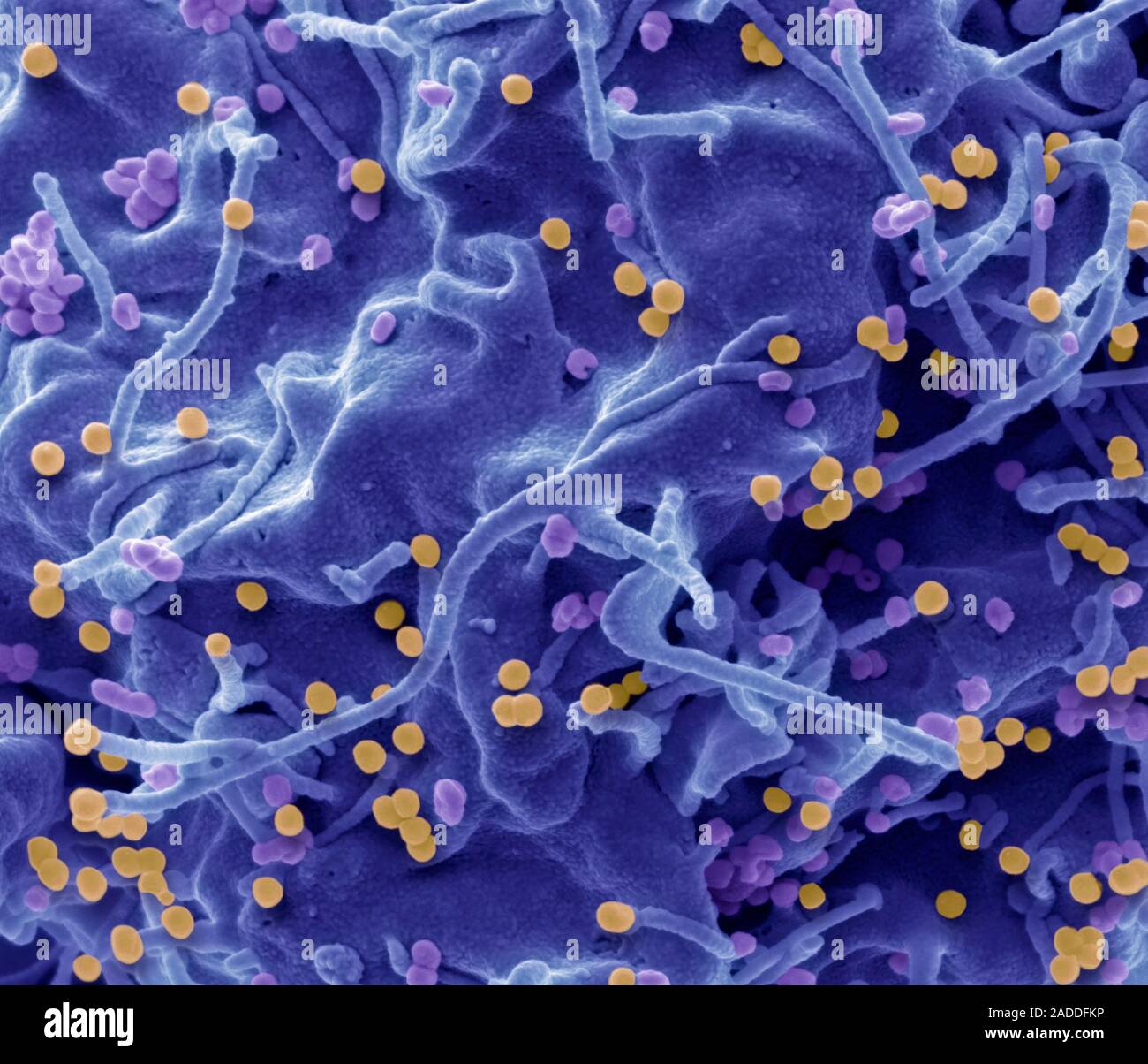 HIV infected 293T cell. Coloured scanning electron micrograph (SEM) of ...