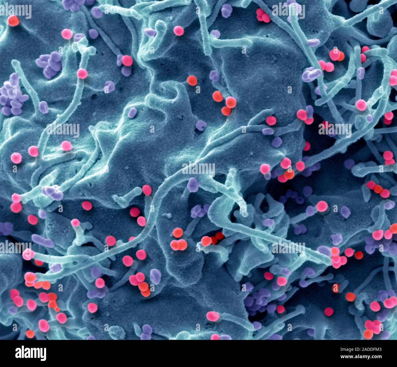 HIV infected 293T cell. Coloured scanning electron micrograph (SEM) of ...