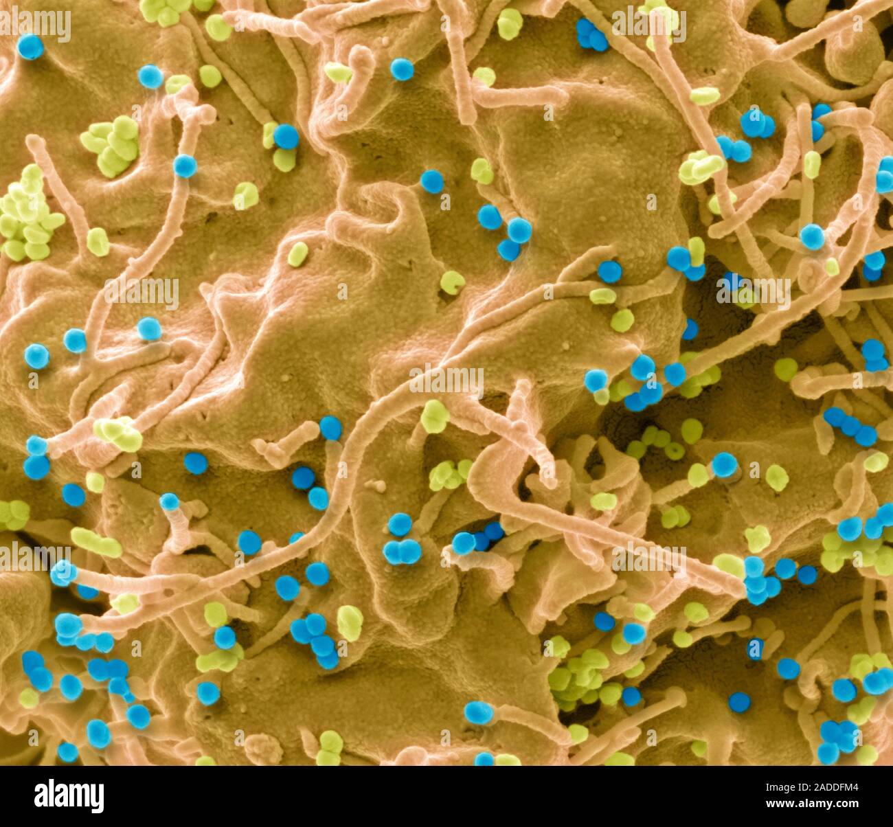 HIV infected 293T cell. Coloured scanning electron micrograph (SEM) of ...