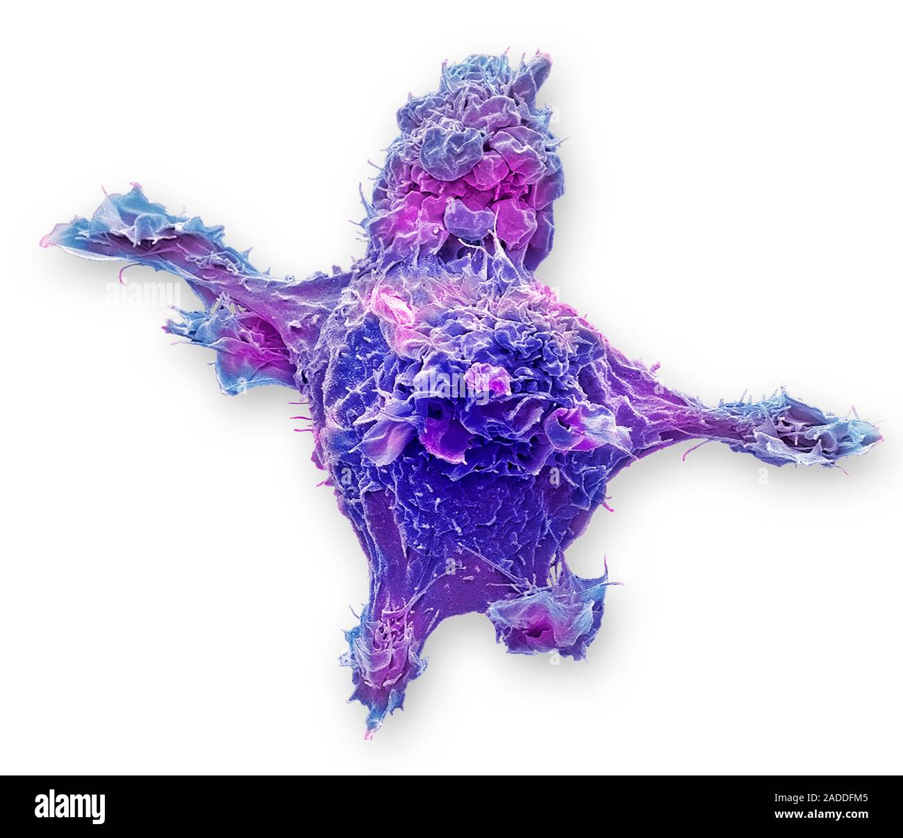 Adenovirus infected 293T cell, coloured scanning electron micrograph ...