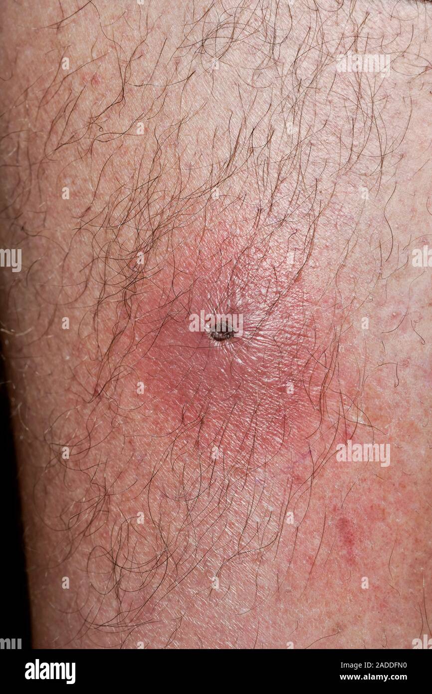 Infected spider bite on the leg of a 49-year-old man. The bite occurred ...