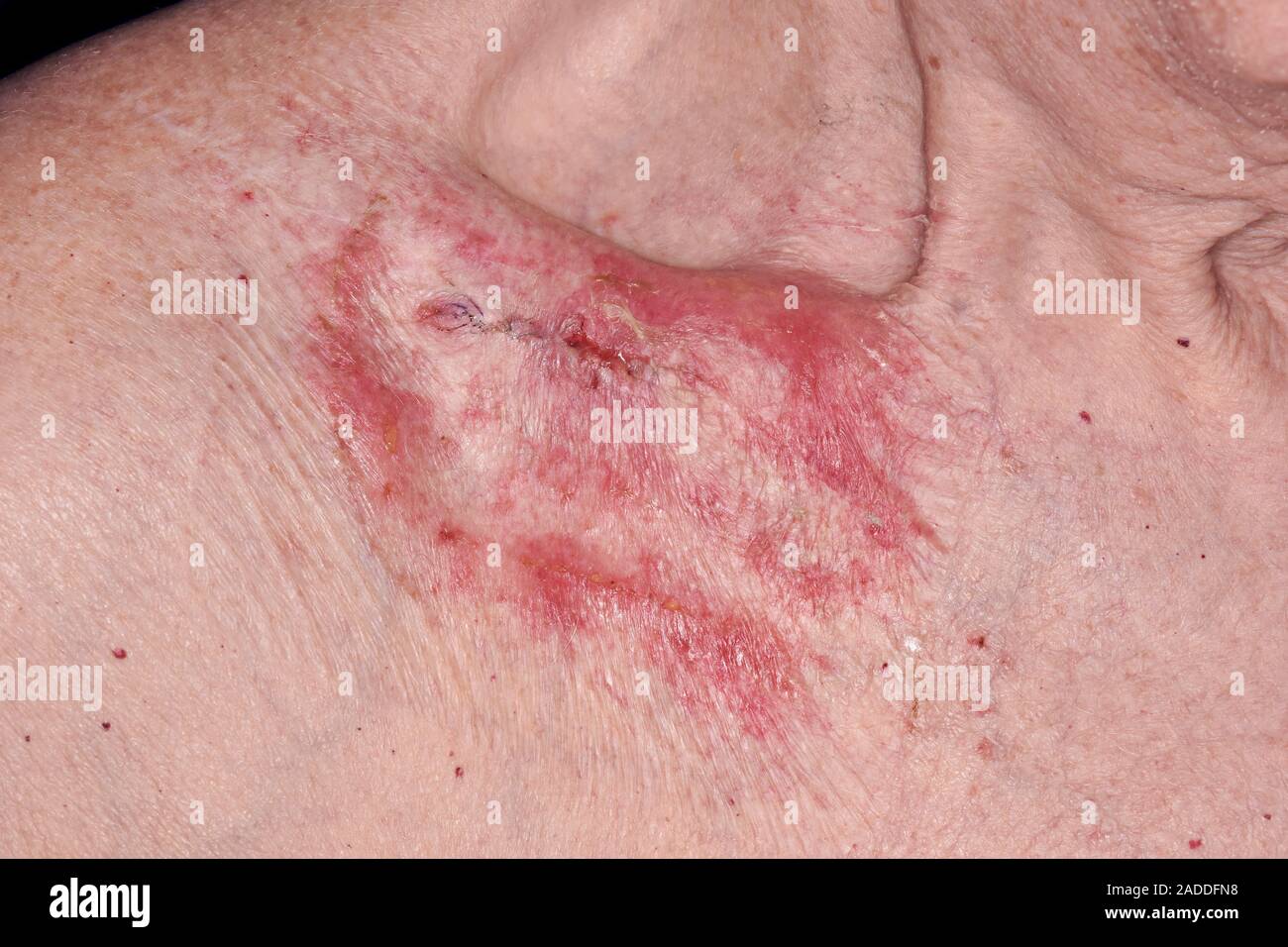 Allergic rash following surgery. Close-up of the shoulder of an 89-year ...
