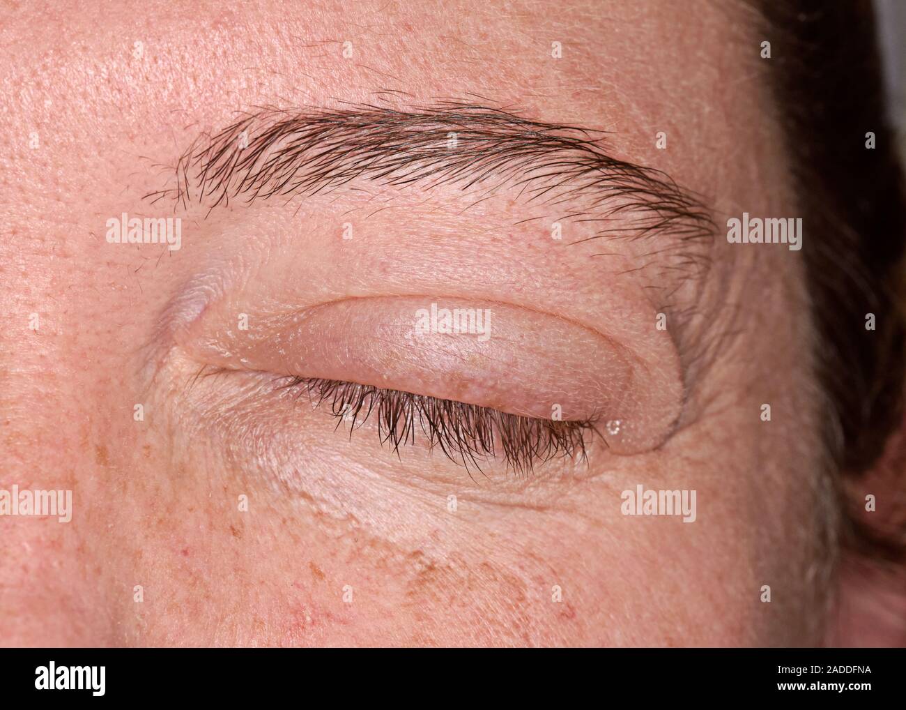 Angioedema swelling of the eyelid of a 42-year-old woman. This swelling ...