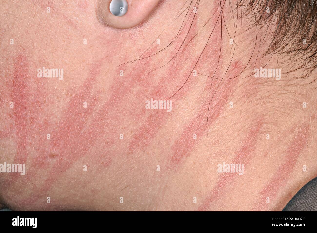 Dermographism. Red lines on the face and neck of a 35-year-old woman in ...