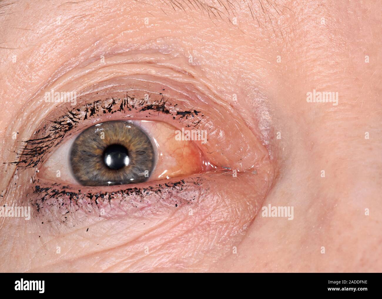 Conjunctival oedema due to allergy in the eye of a 57-year-old woman ...