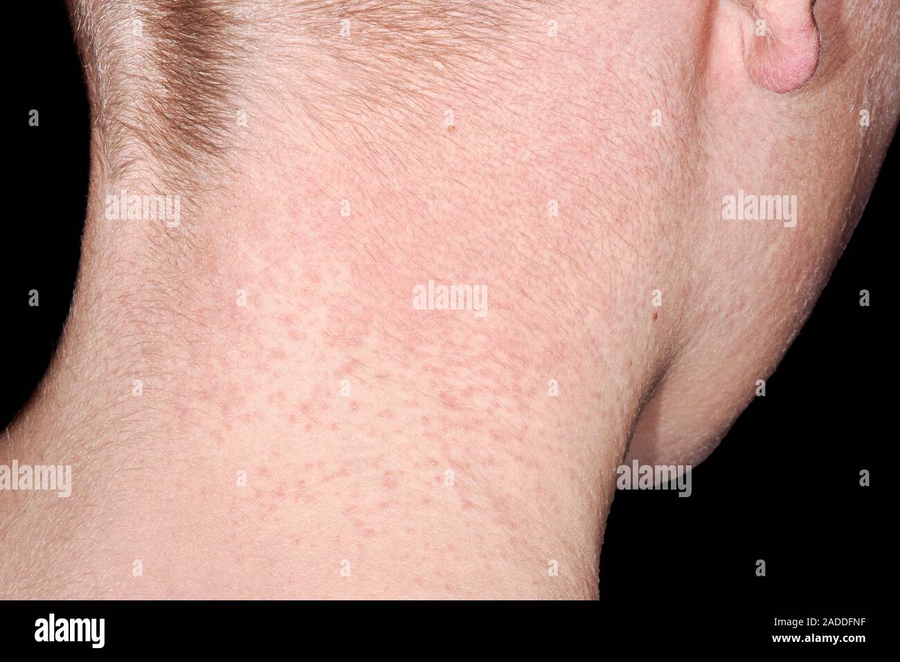 Allergic reaction to clothing affecting the skin on the neck of an 11 ...