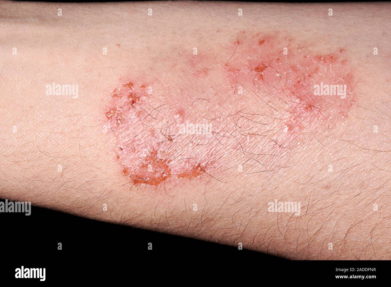 Ringworm fungal infection (tinea) on the arm of a 23-year-old woman ...
