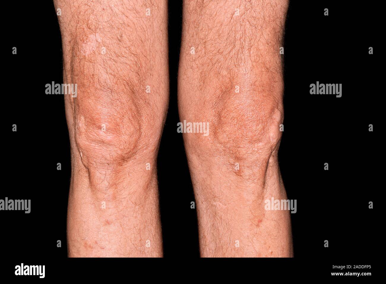 Post-operative arthritis of the knee in a 68-year-old man. There is ...