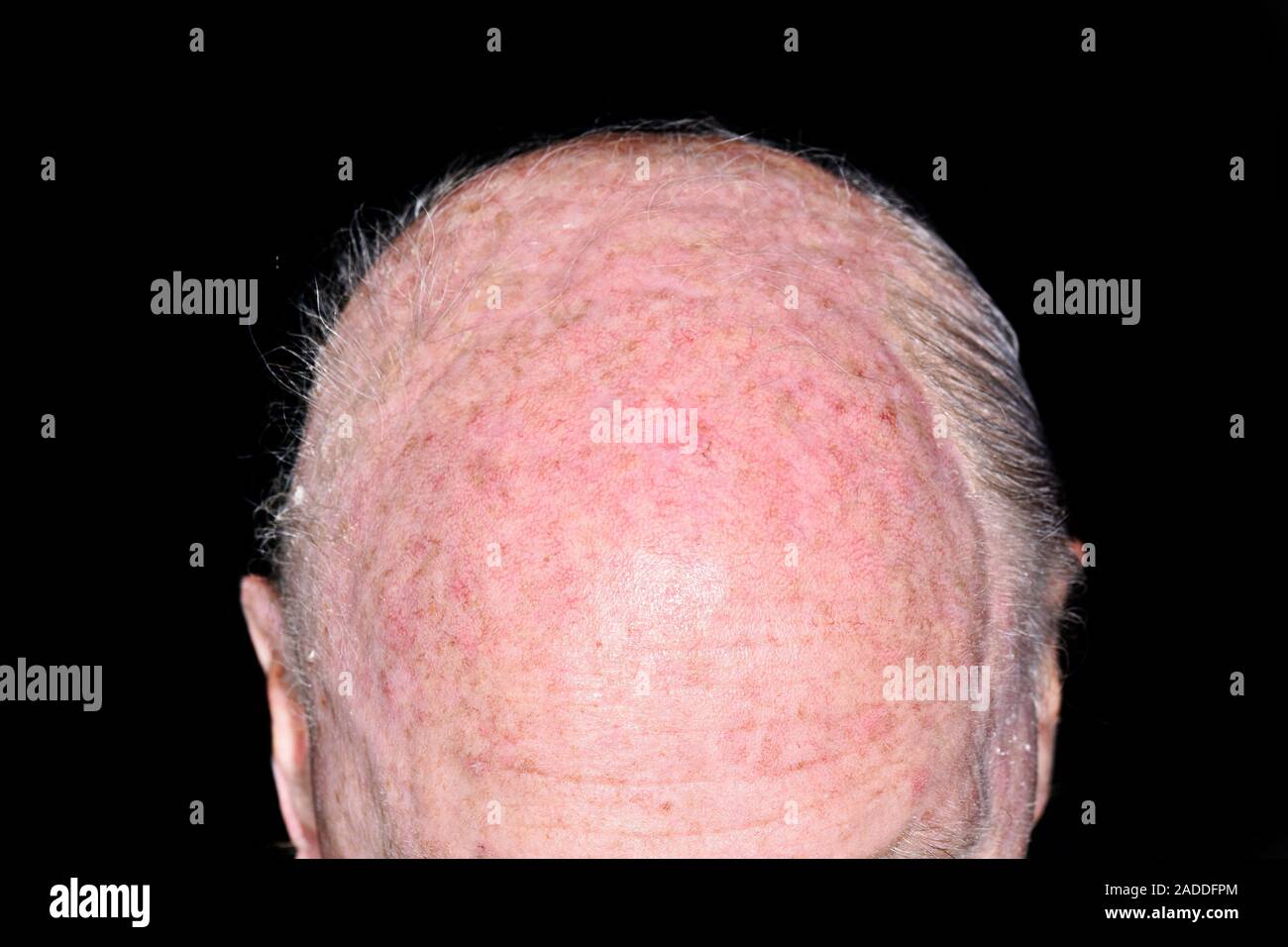 Hair loss due to chemotherapy for metastatic (secondary) bowel cancer ...
