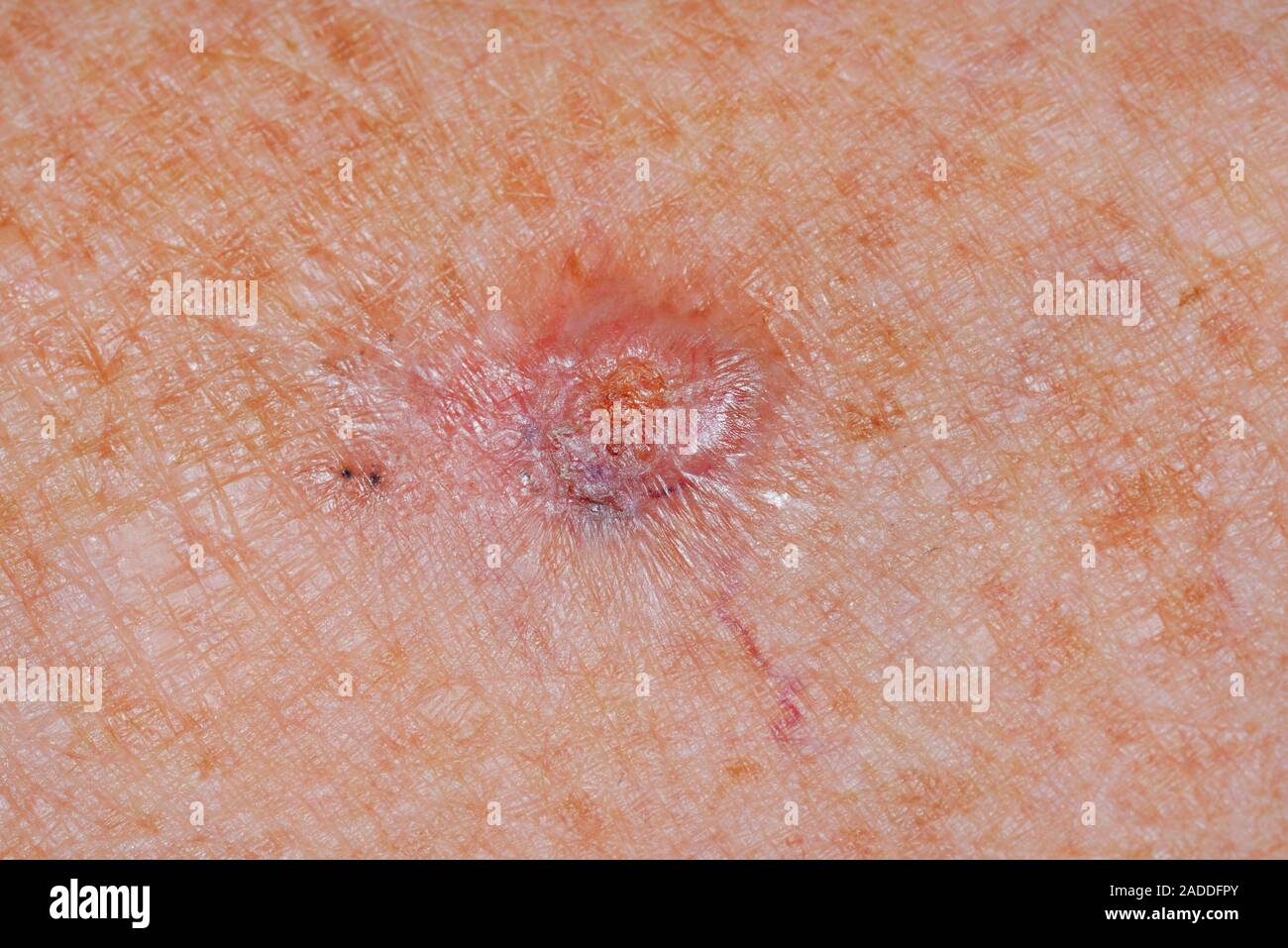 Basal cell carcinoma on the arm of a 92-year-old woman. Basal cell ...