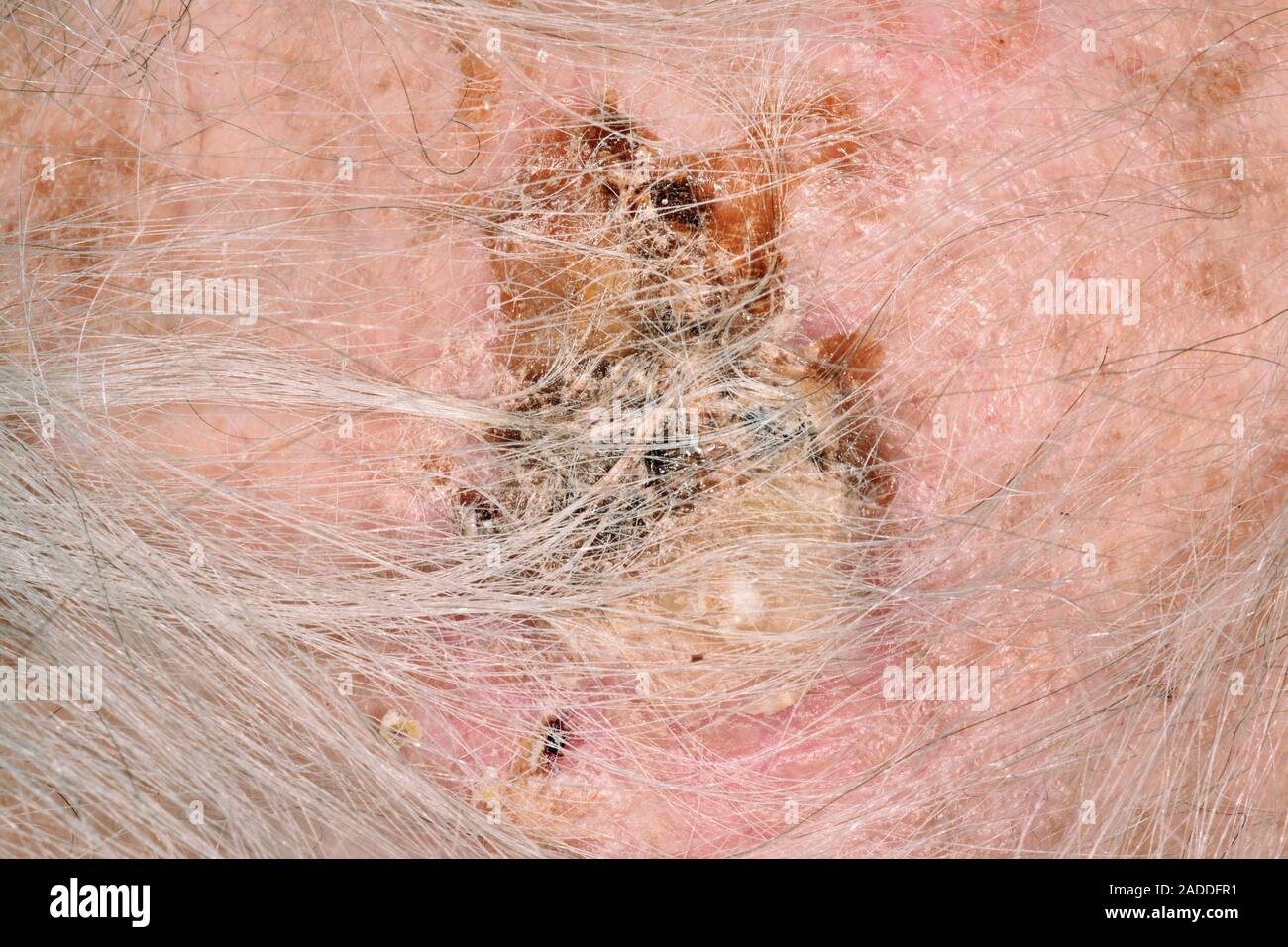 Squamous Cell Carcinoma On The Scalp Of A 90 Year Old Man This Form Of