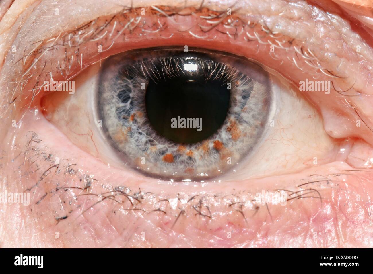 Cataract in the right eye of an 80-year-old woman. A cataract is a ...