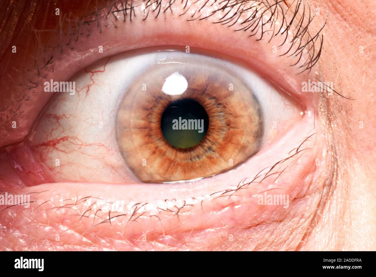 Cataract in the left eye of an 75-year-old woman. A cataract is a ...