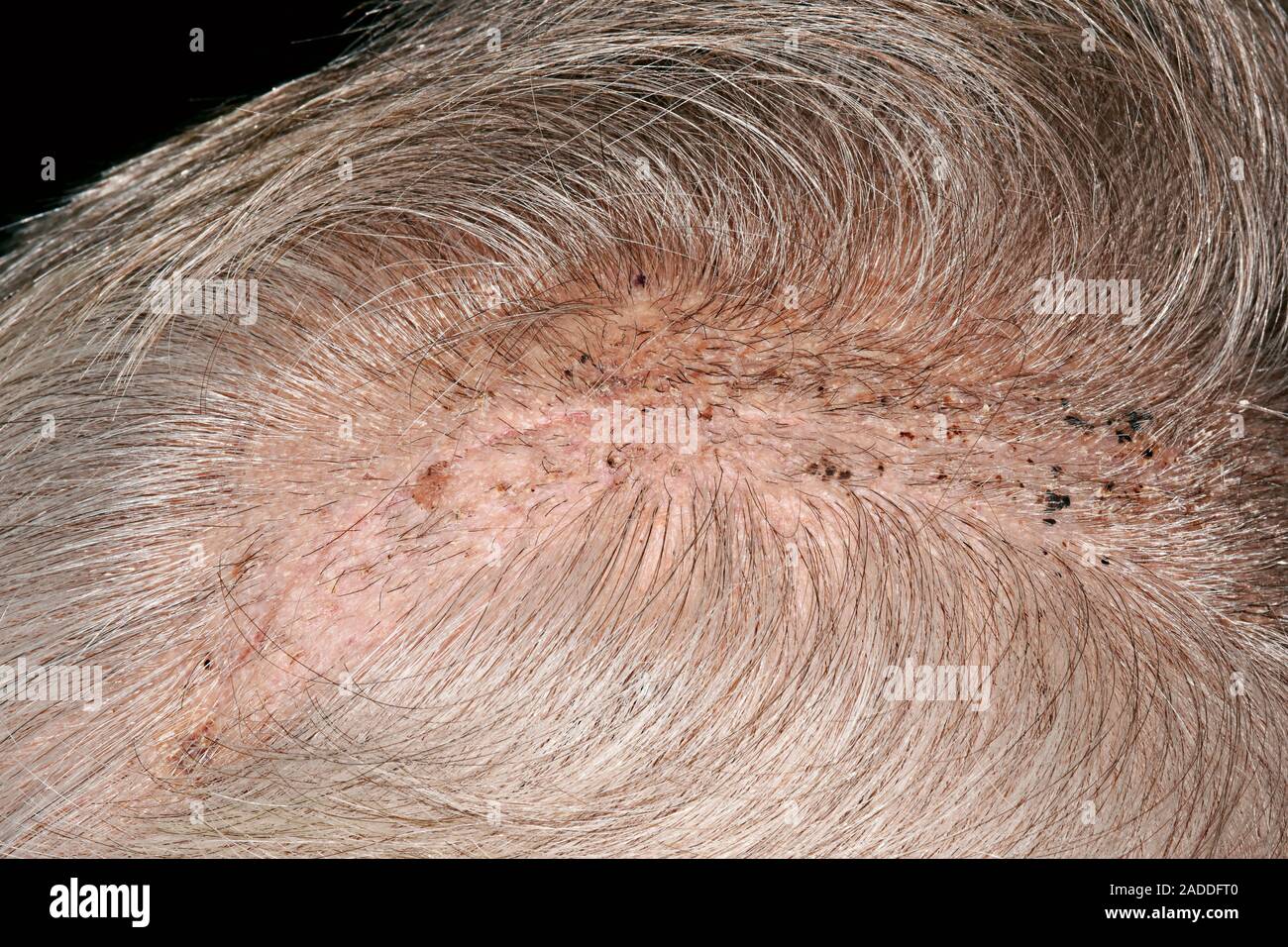 Post-operative craniotomy scar on the scalp of a 69-year-old woman ...