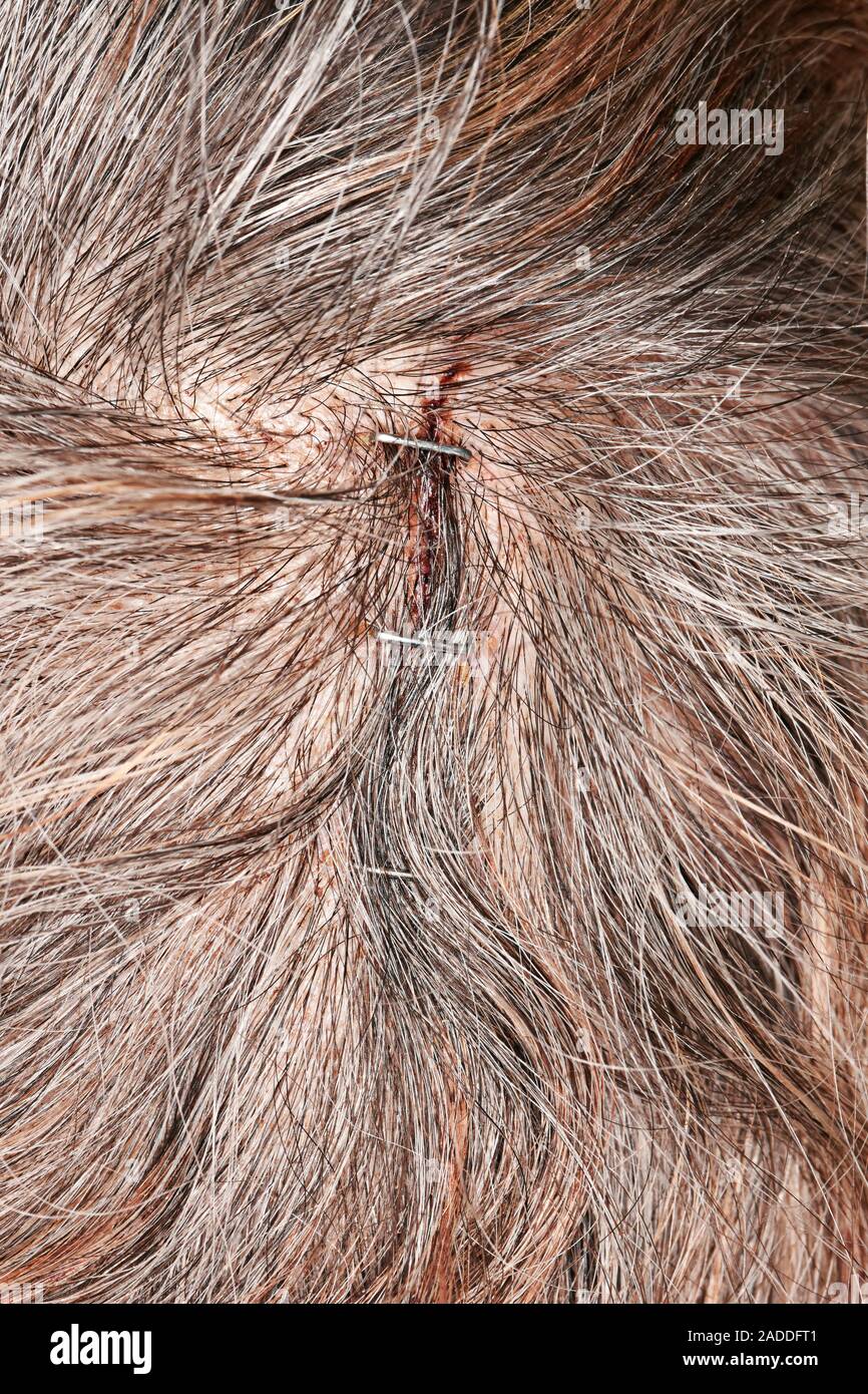 Stapled scalp laceration (cut) on the head of a 77-year-old man. He cut ...