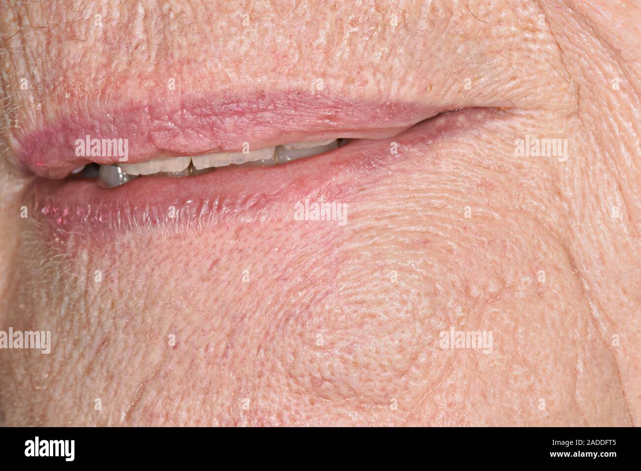 Scar after squamous cell carcinoma excision from the lip of a 69-year ...