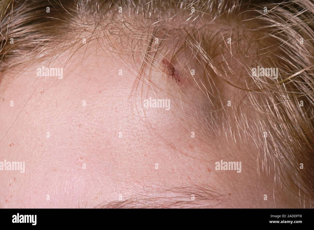 Haematoma (internal bleeding) on the forehead of a 9-year-old girl ...