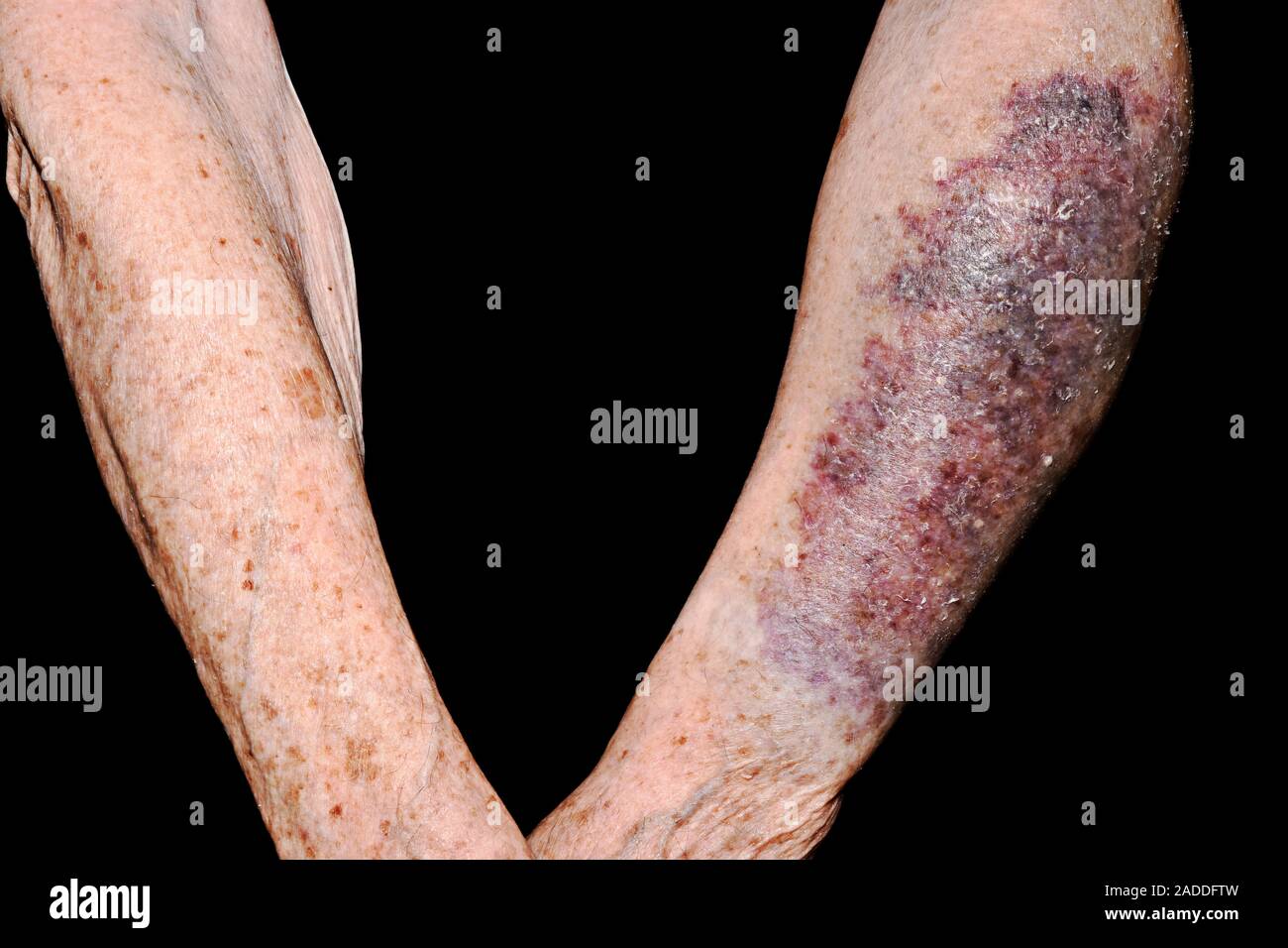 Internal Bleeding Hand