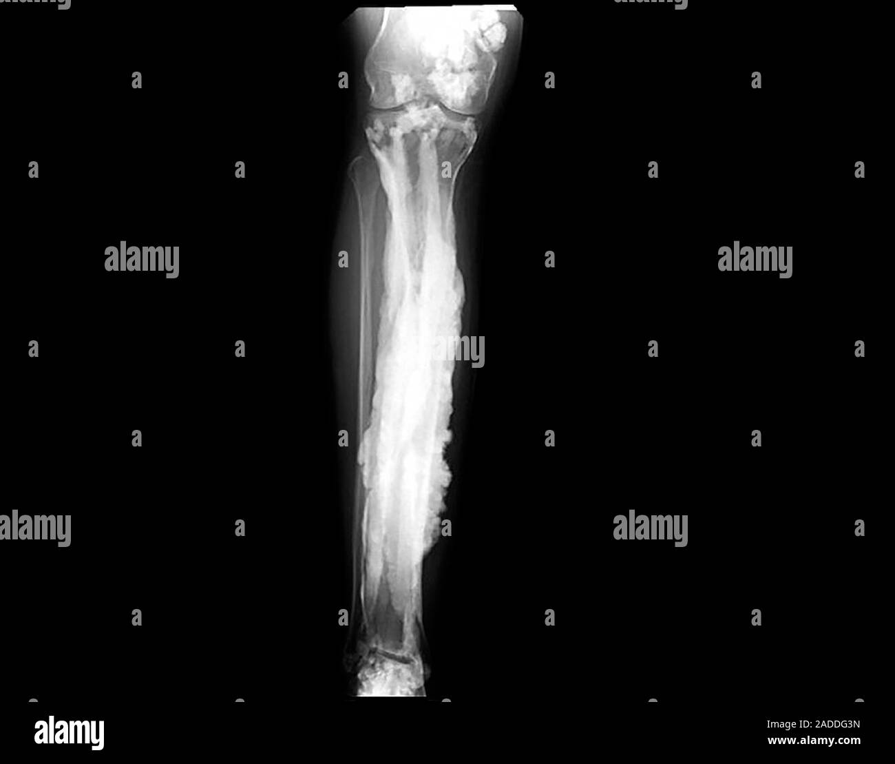 Melorheostosis of the lower leg. X-ray of lower leg of a patient with ...