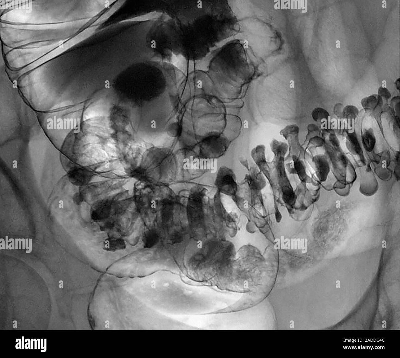 Diverticulosis in large intestine, X-ray. Diverticulosis causes sacs ...