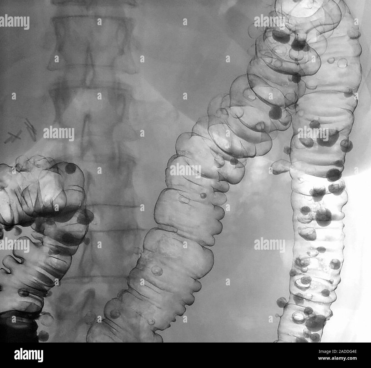 Diverticulosis in large intestine, X-ray. Diverticulosis causes sacs ...