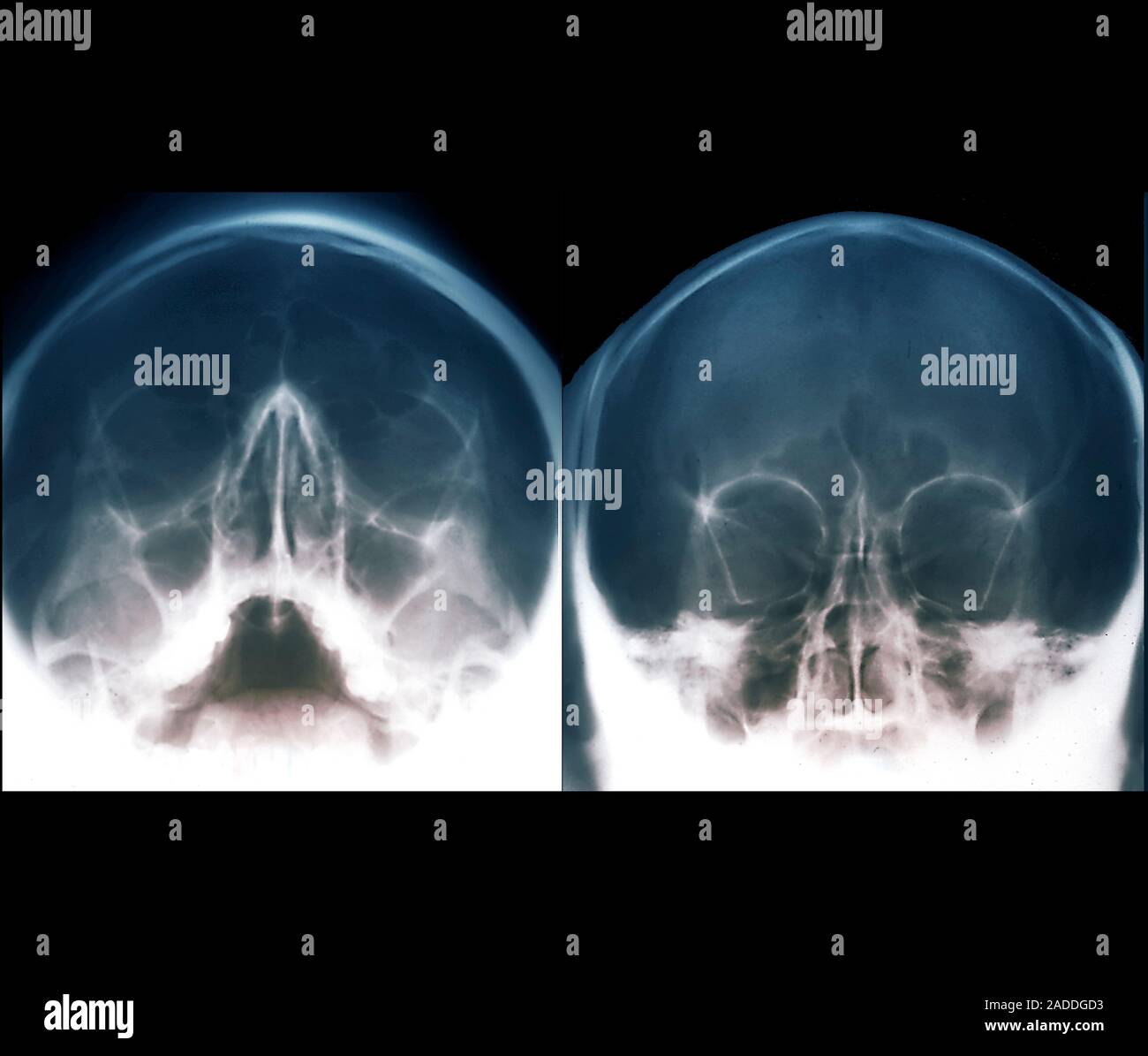 Paranasal sinuses. Two head X-rays showing a patient's paranasal ...