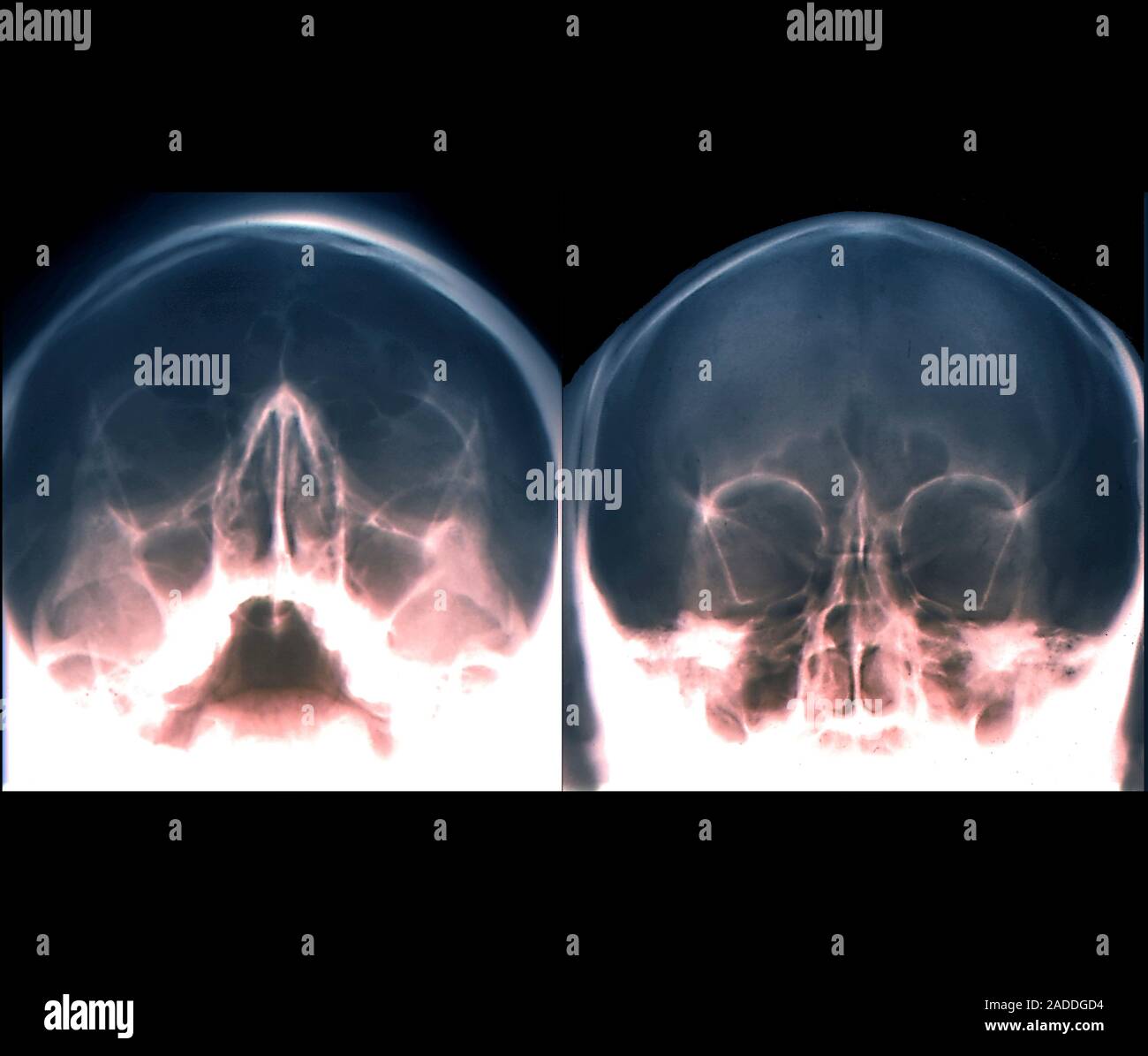 Paranasal sinuses. Two head X-rays showing a patient's paranasal ...