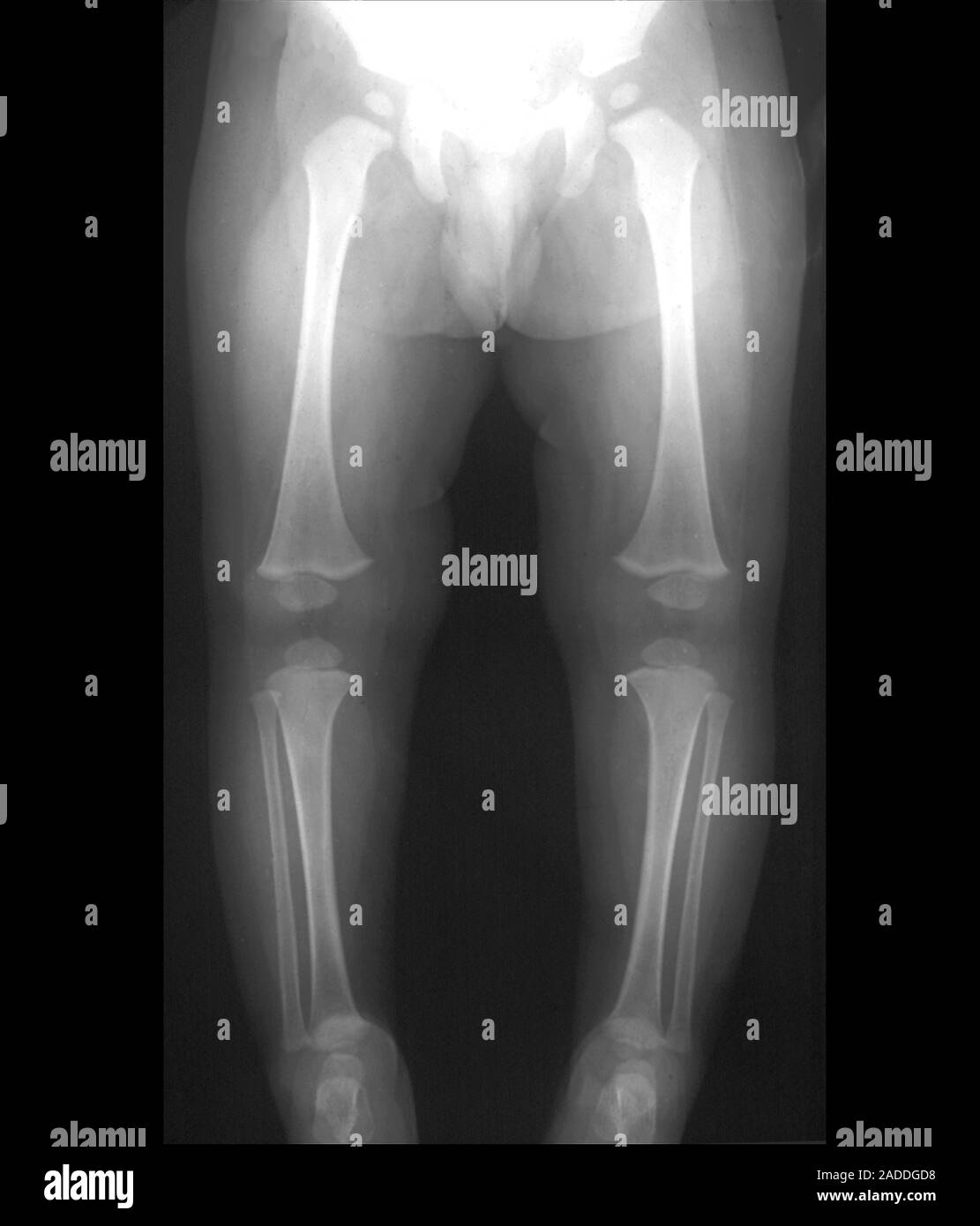 Leg bones of 18-month-old infant, frontal X-ray. This X-ray shows the ...