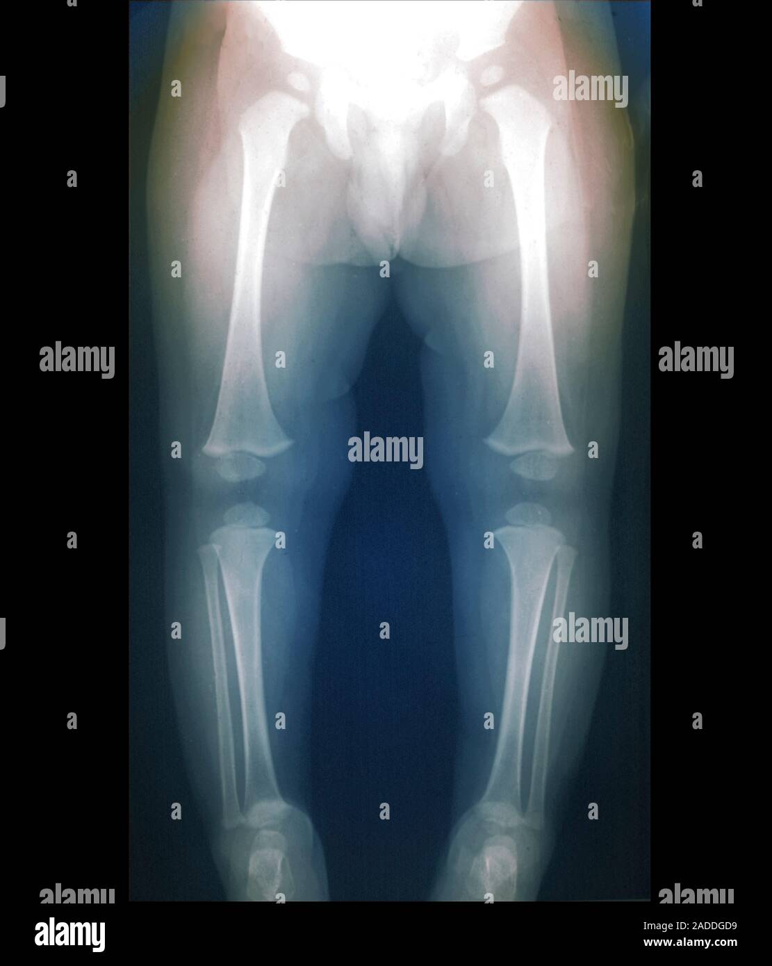 Leg bones of 18-month-old infant, coloured frontal X-ray. This X-ray ...
