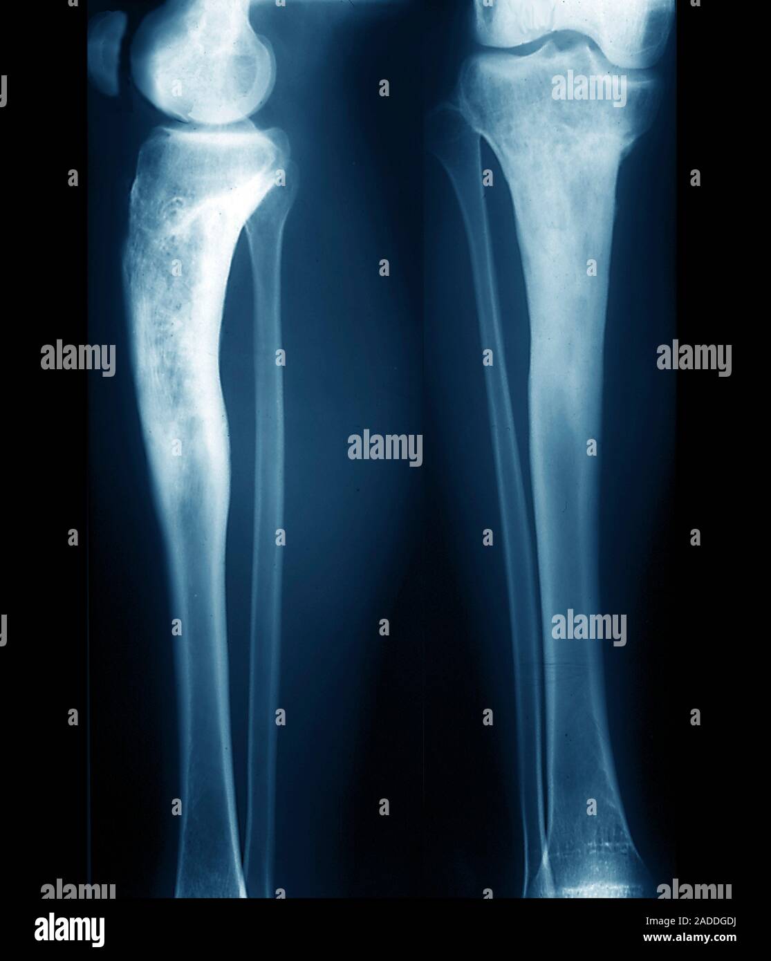 Osteomyelitis in the lower leg. Coloured X-rays of the lower right leg ...