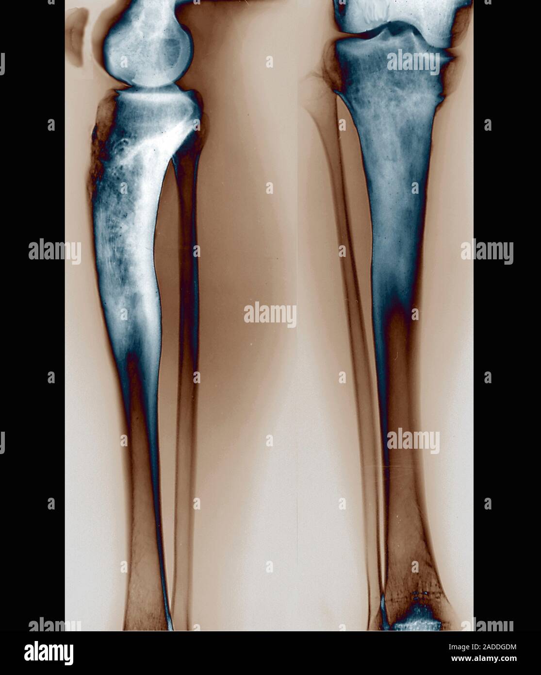 Osteomyelitis in the lower leg. Coloured X-rays of the lower right leg ...